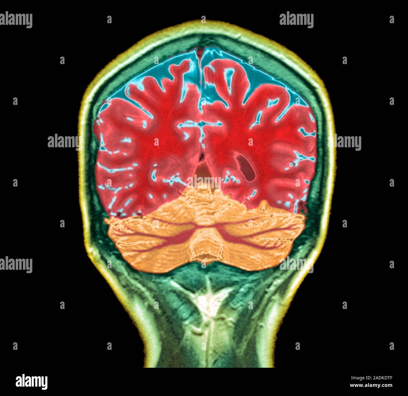Healthy brain. Coloured magnetic resonance imaging (MRI) scan through ...