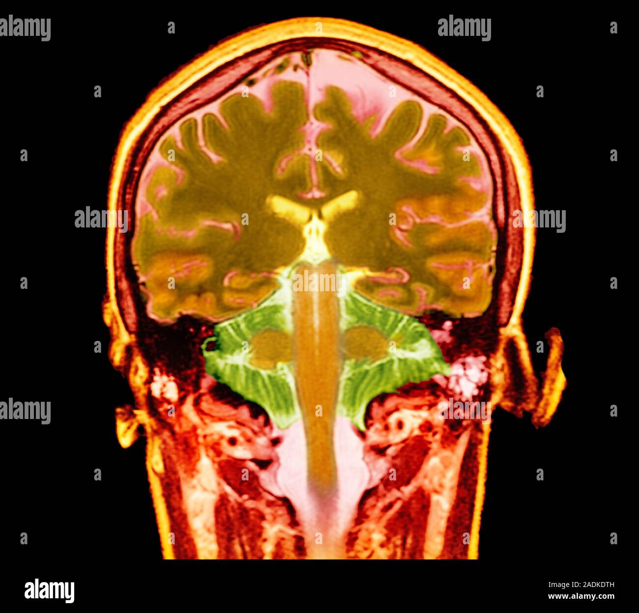 Healthy brain. Coloured magnetic resonance imaging (MRI) scan through ...