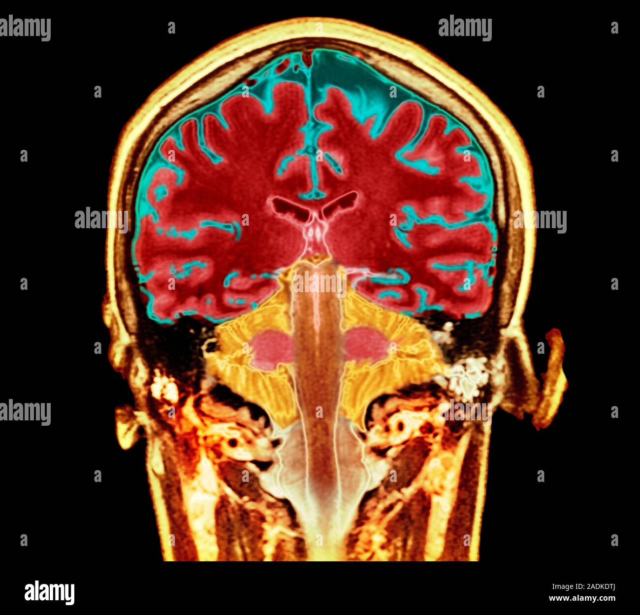 Healthy brain. Coloured magnetic resonance imaging (MRI) scan through ...