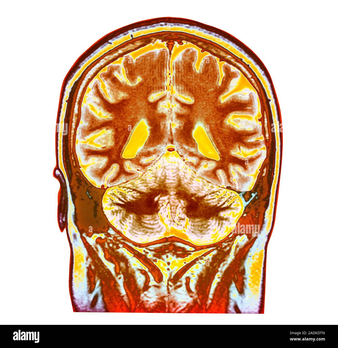 Healthy brain. Coloured magnetic resonance imaging (MRI) scan through ...
