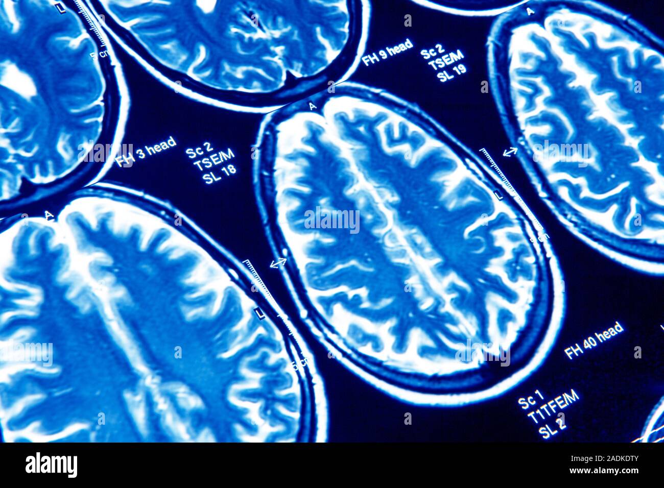 Brain scans. Magnetic resonance imaging (MRI) scans of axial ...