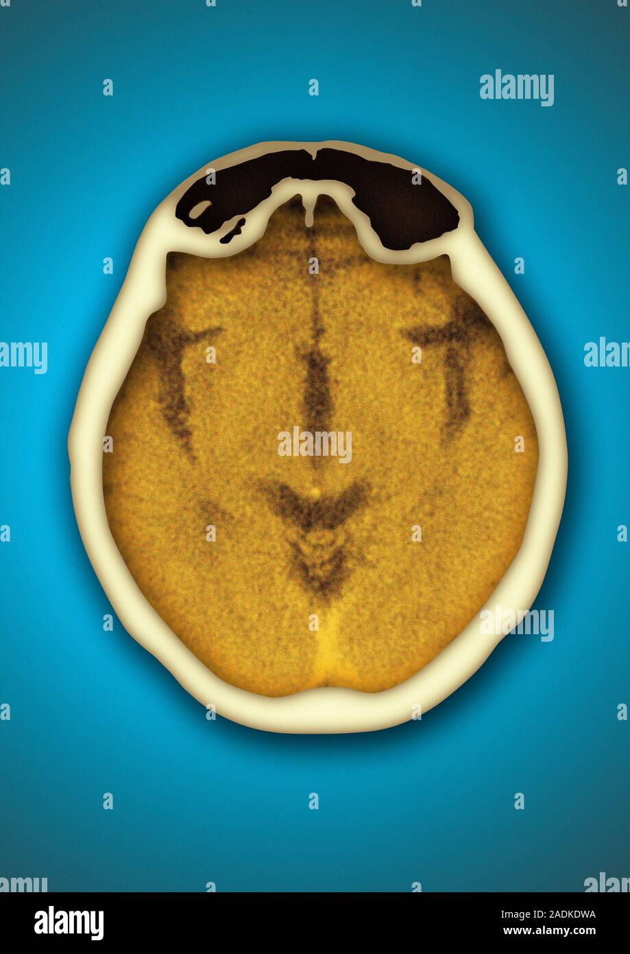 Healthy brain and frontal sinus. Coloured computed tomography (CT) scan ...