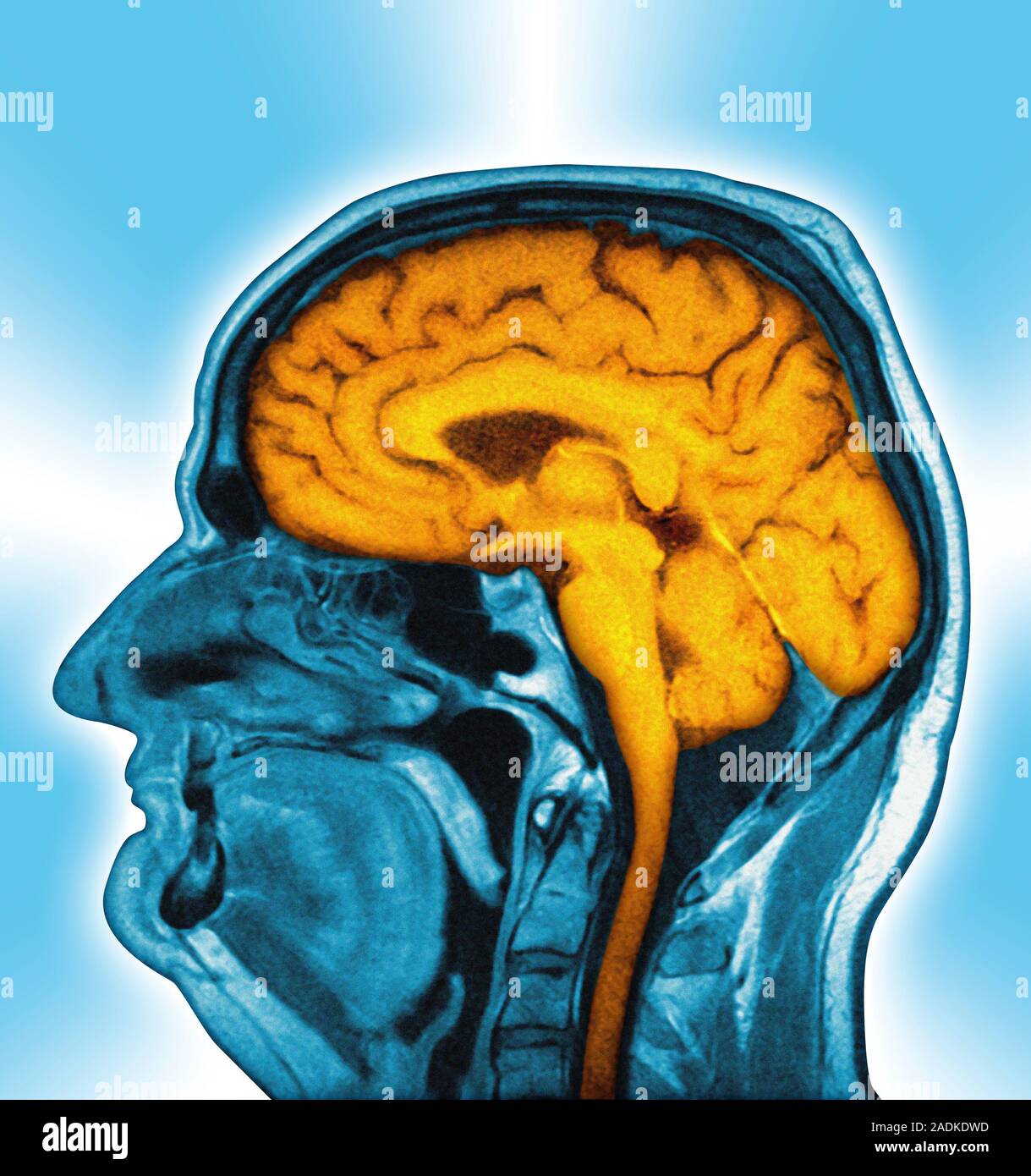 Normal human brain. Coloured magnetic resonance imaging (MRI) scan of a human head. The sagittal ...