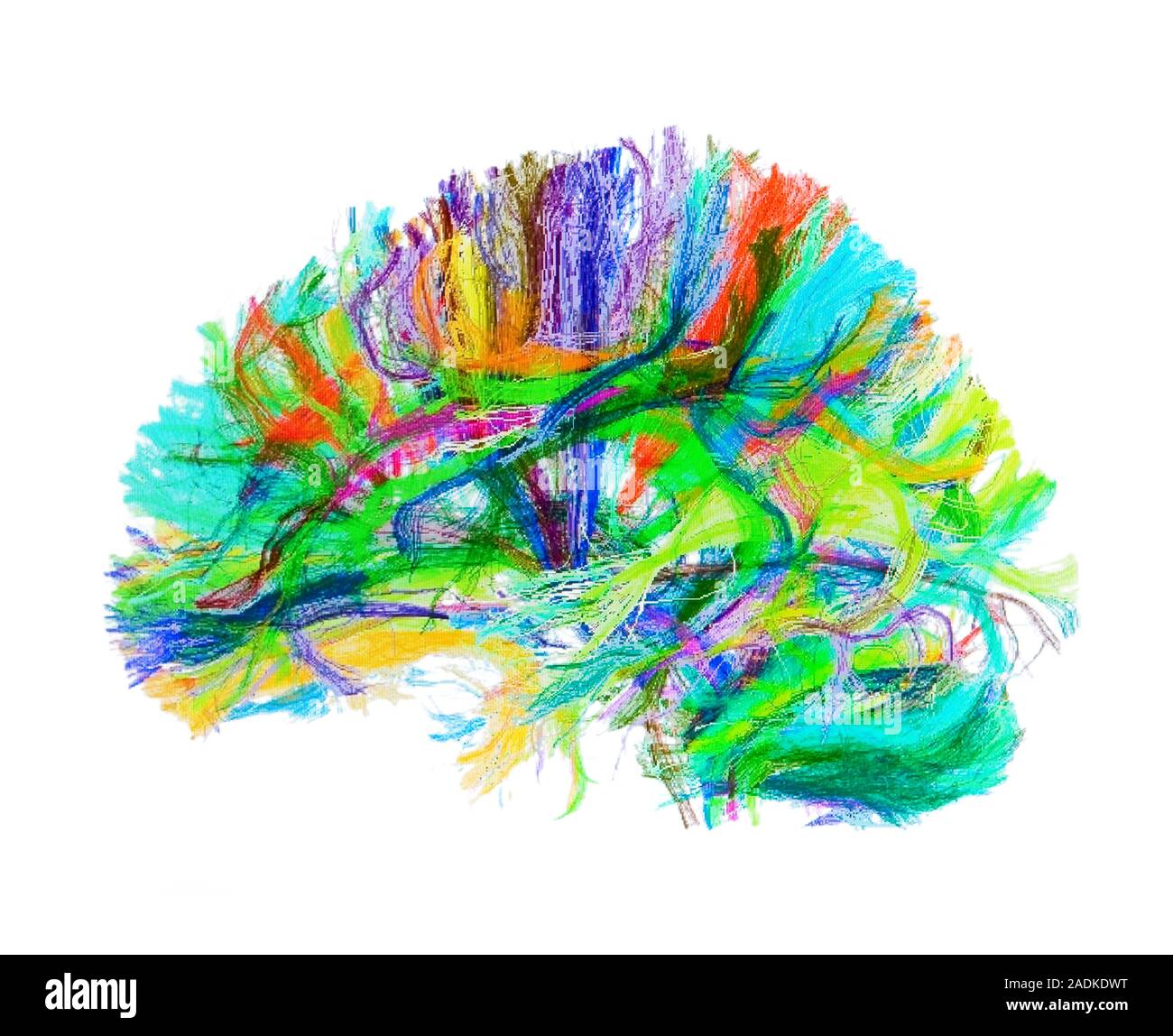 Advanced MRI brain scan. This 3D magnetic resonance imaging (MRI) scan ...