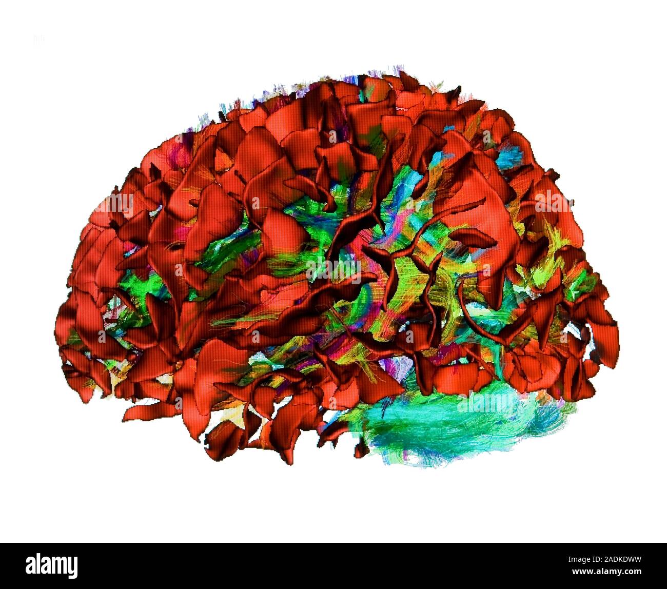 Advanced MRI brain scan. This 3D magnetic resonance imaging (MRI) scan ...