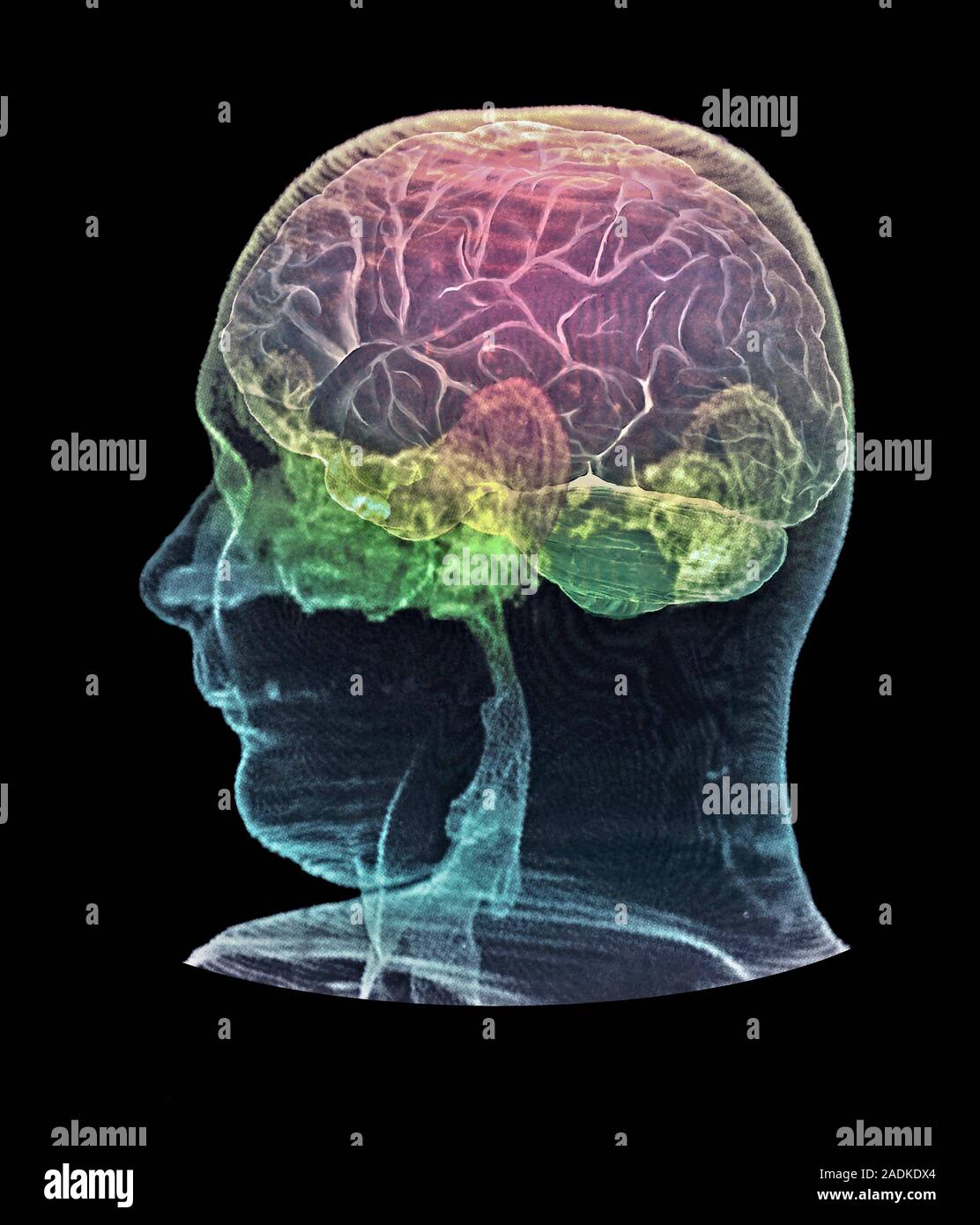 Normal brain. Coloured three-dimensional magnetic resonance imaging (MRI) scan of a human head ...