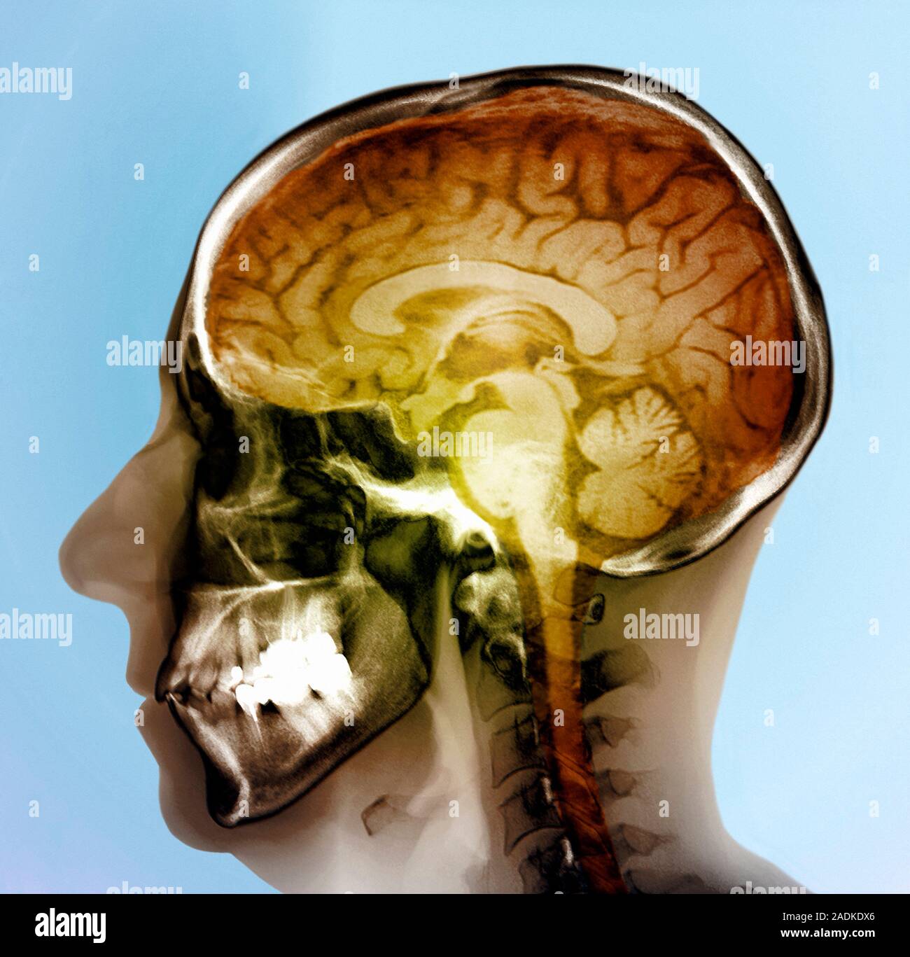 Normal brain, coloured magnetic resonance imaging (MRI) scan. Sagittal (side) view of a human ...