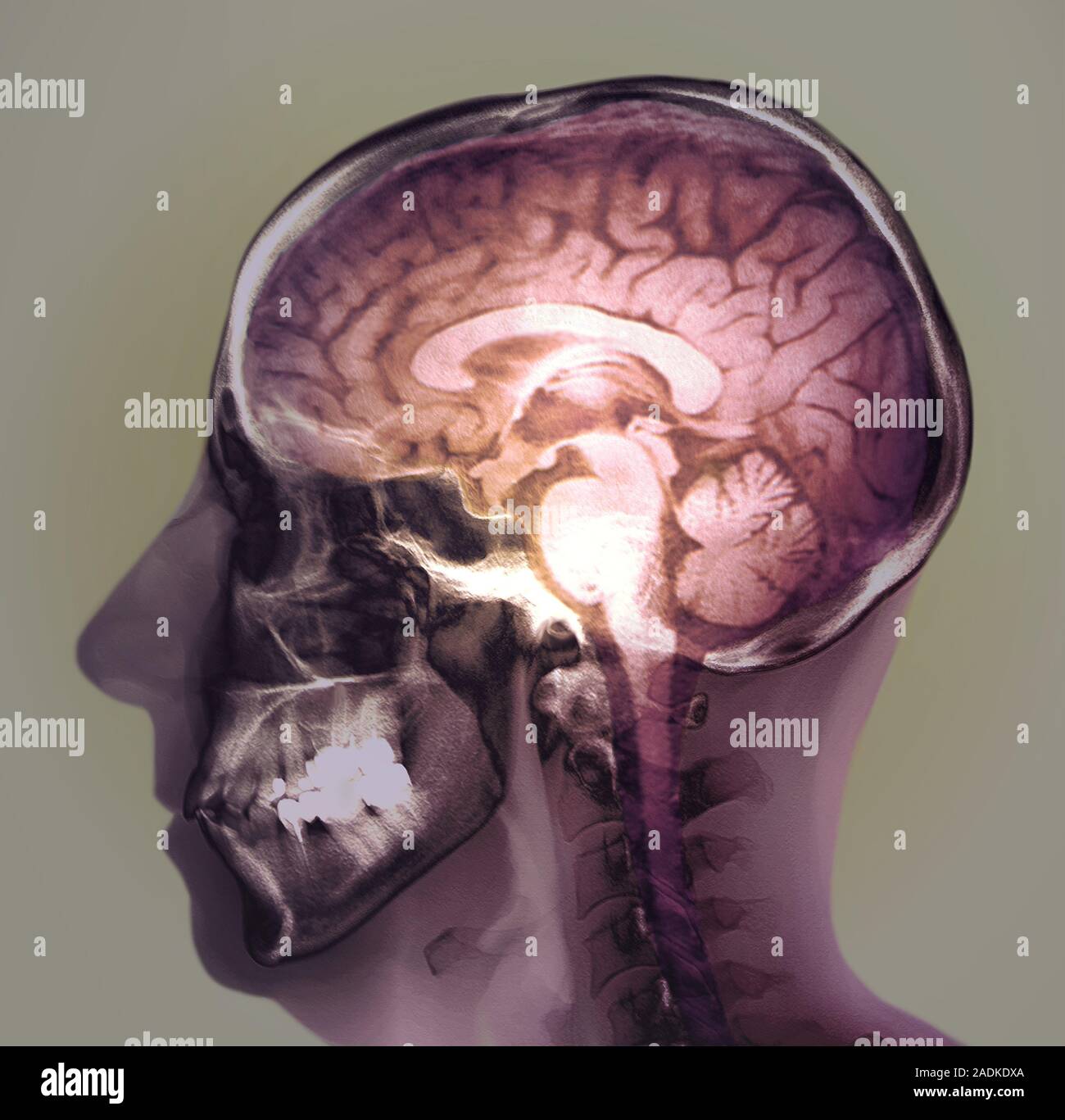 Normal brain, coloured magnetic resonance imaging (MRI) scan. Sagittal (side) view of a human ...