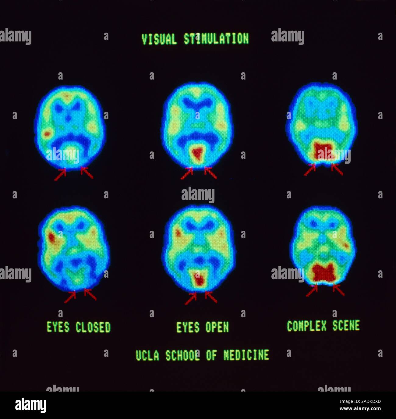 Positron computed tomography (PCT) scans of the brain, comparing 3 ...