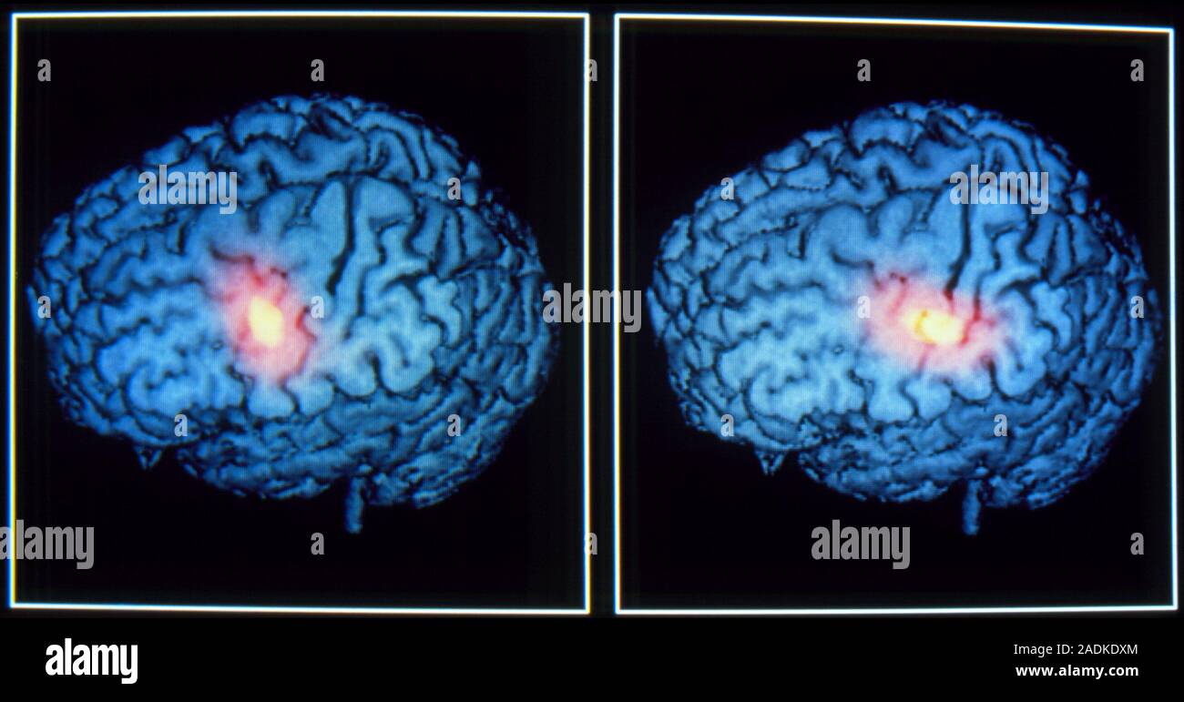 Brain-hand control from MEG scan. Two computer images of the human ...