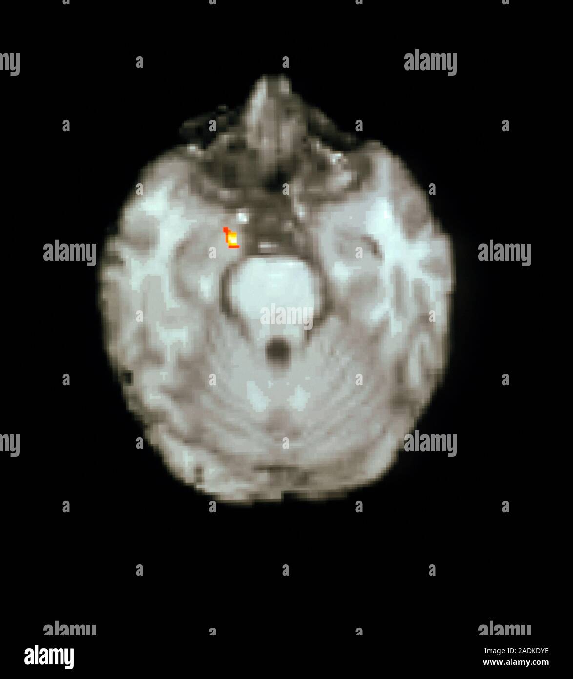 Brain response to fear. Coloured positron emission tomography (PET ...