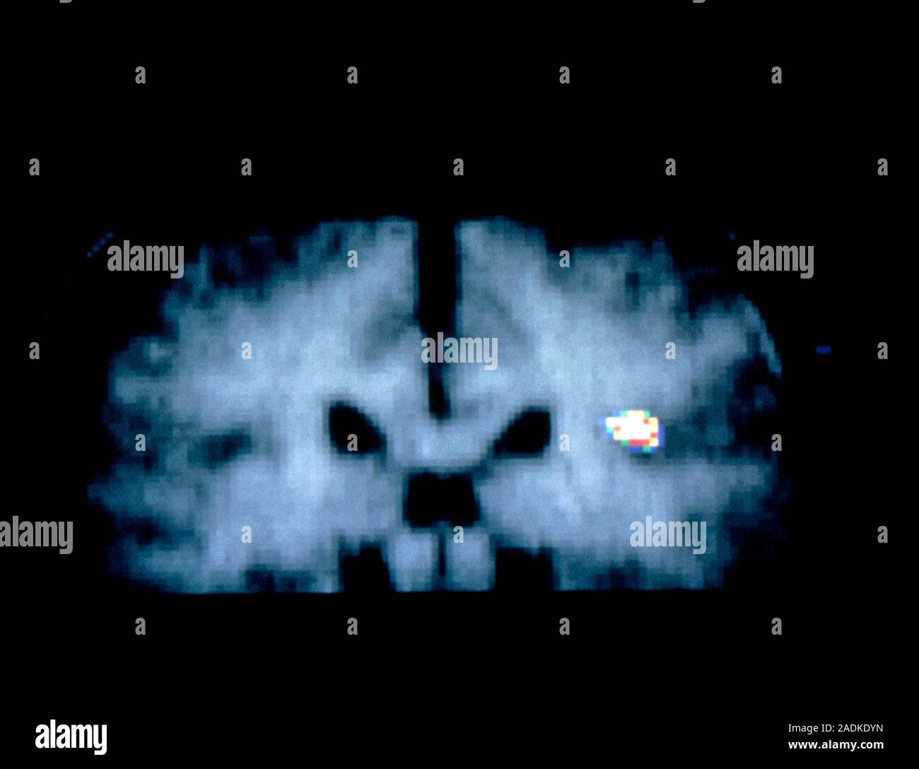 Brain's taste centre. Coloured positron emission tomography (PET) scan ...