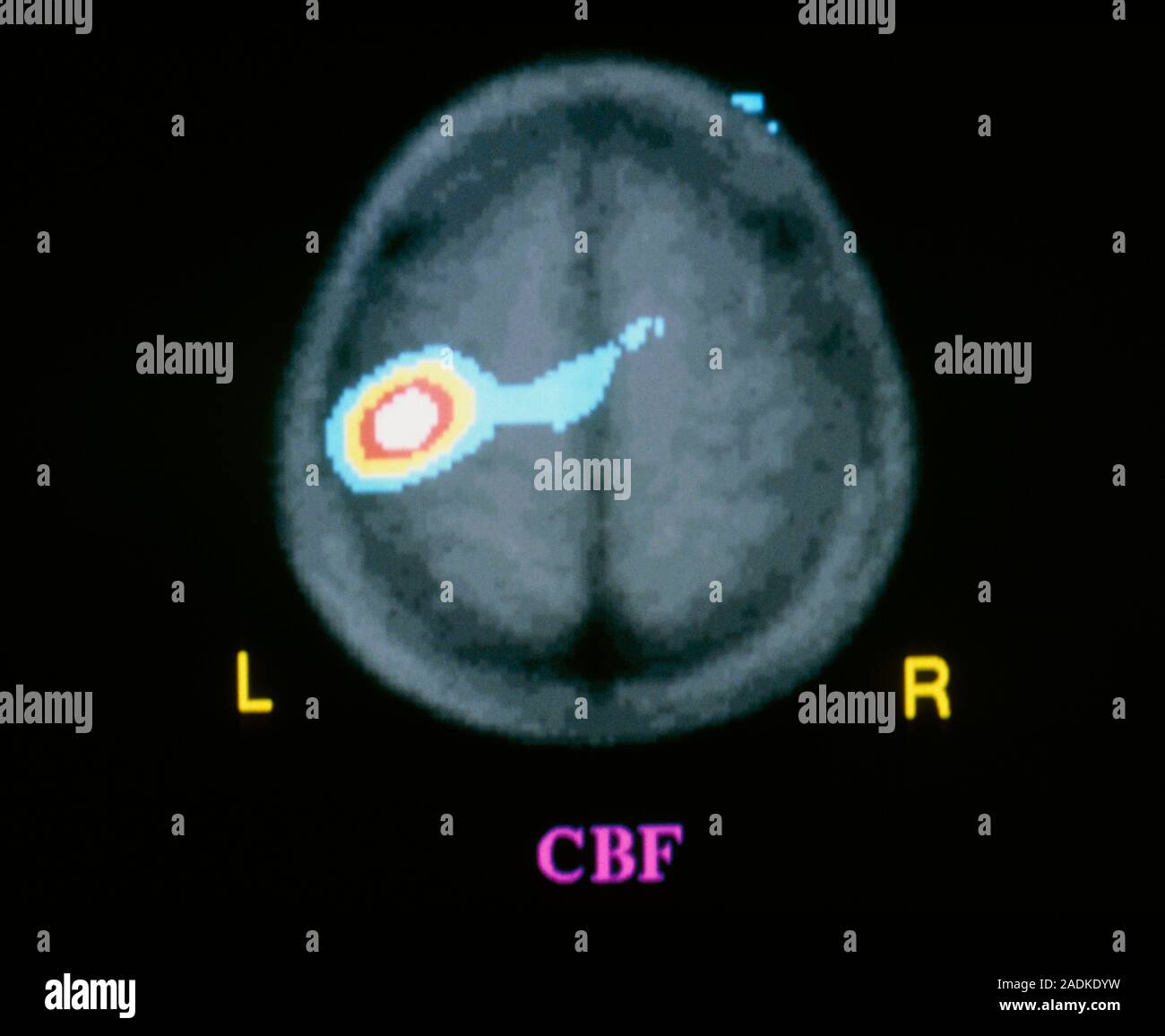 Tactile stimulation. Coloured positron emission tomography (PET) scan ...