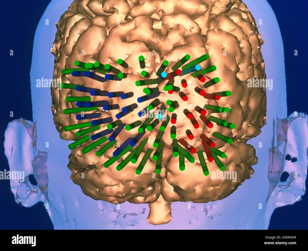 Visual cortex brain areas. 3-D magnetic resonance imaging (MRI) scan of ...
