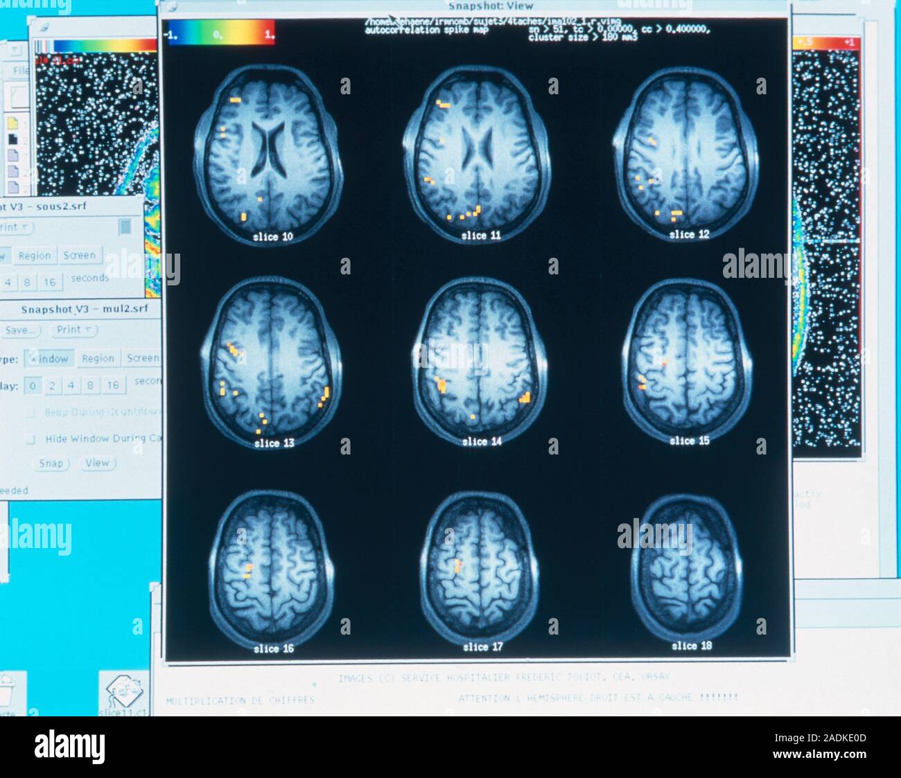 Mathematical brain activity. Co-registered EEG (electroencephalogram) - MRI (magnetic resonance ...