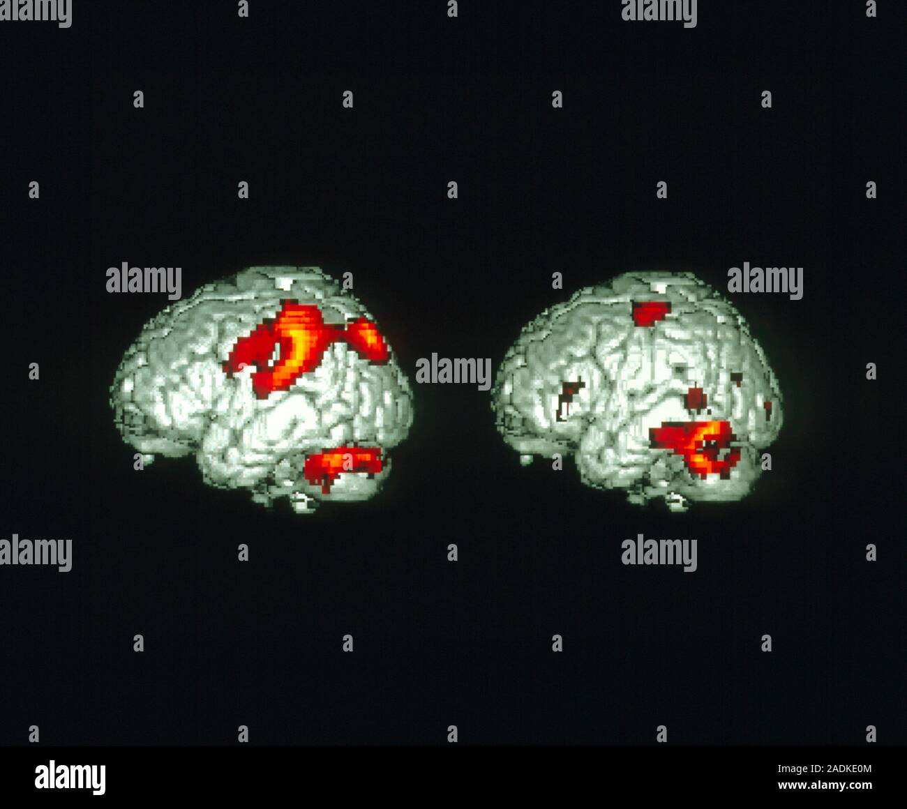 Brain activity reading braille. Coloured positron emission tomography ...