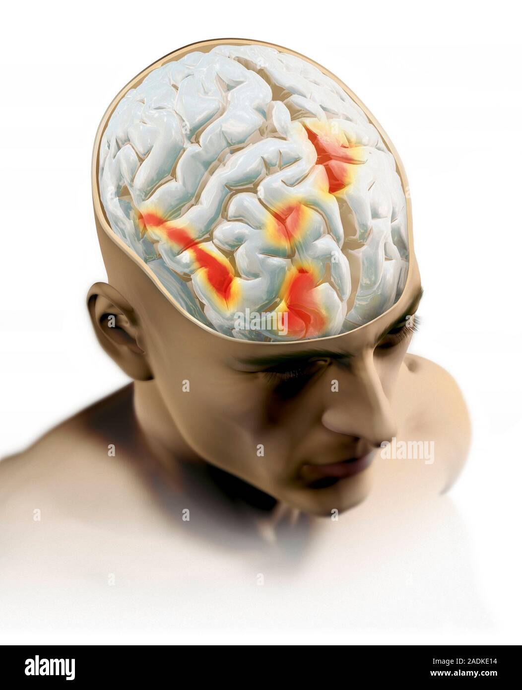 Placebo effect in the brain. Cutaway artwork of a human brain, showing ...
