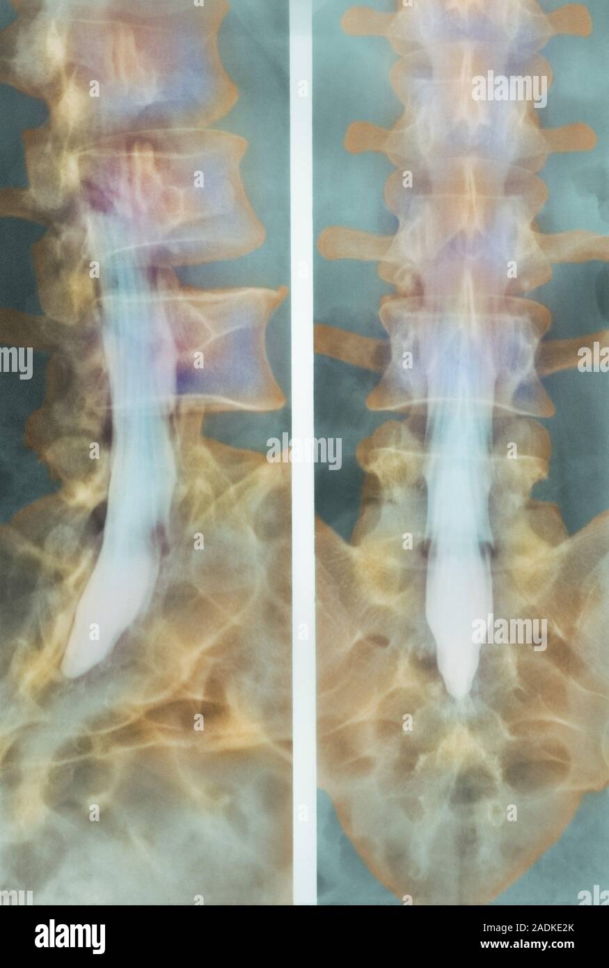 Spinal cord. Coloured myelogram (spinal cord X- ray) of a healthy human ...