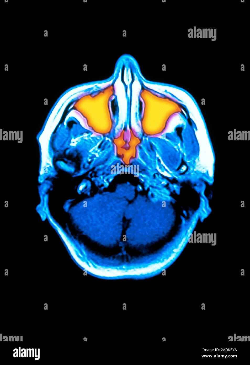 Sinuses. Coloured Magnetic Resonance Imaging (MRI) scan of a person's ...