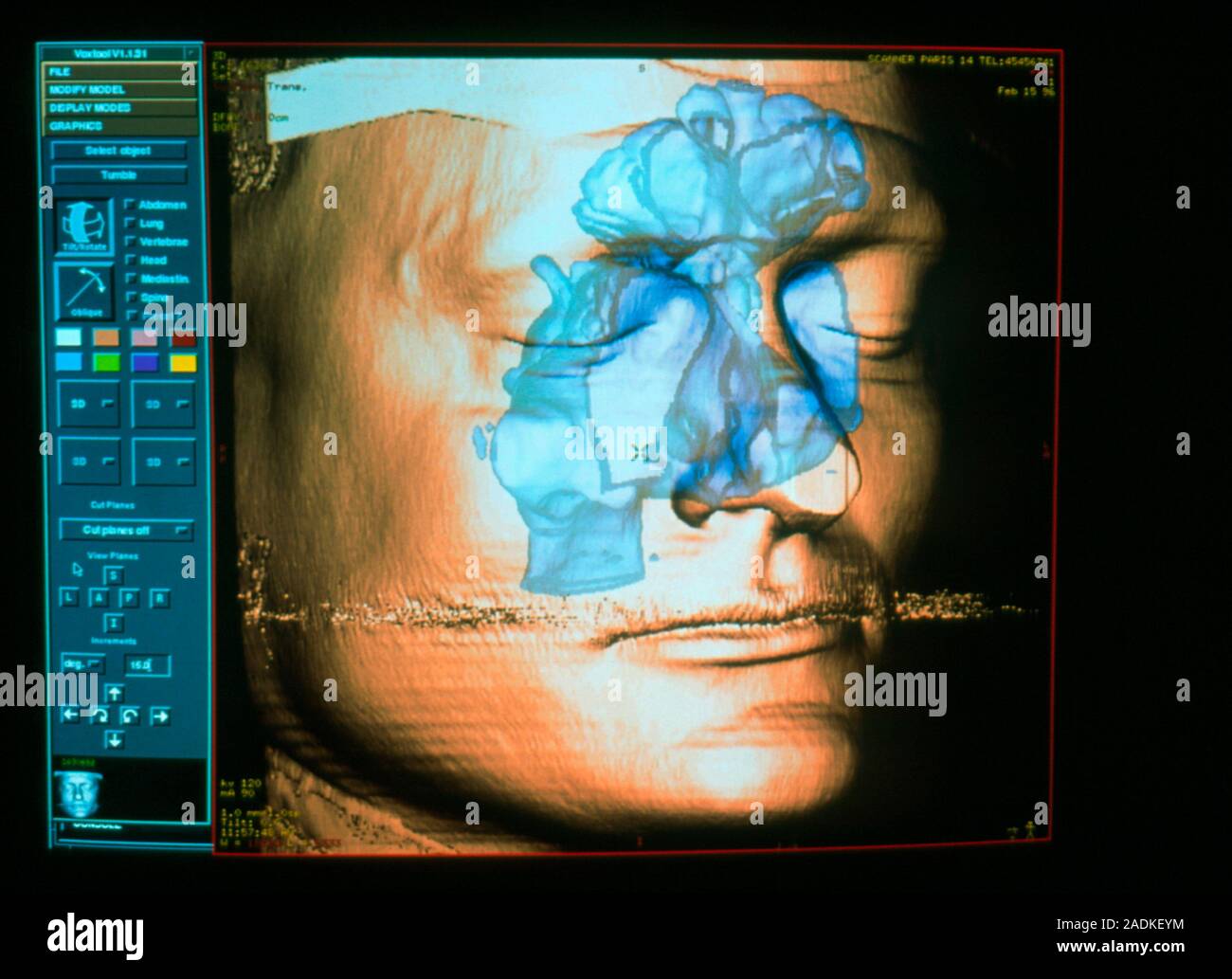Facial sinuses. Three-dimensional computed tomography (CT) scan of the ...