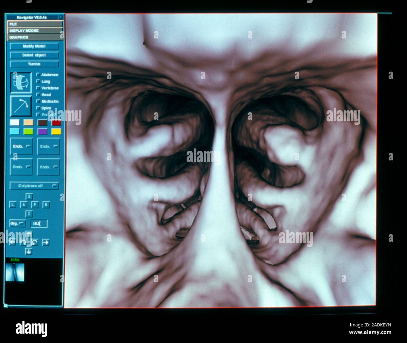 Nasal conchae. Three-dimensional computed tomography (CT) scan of the ...