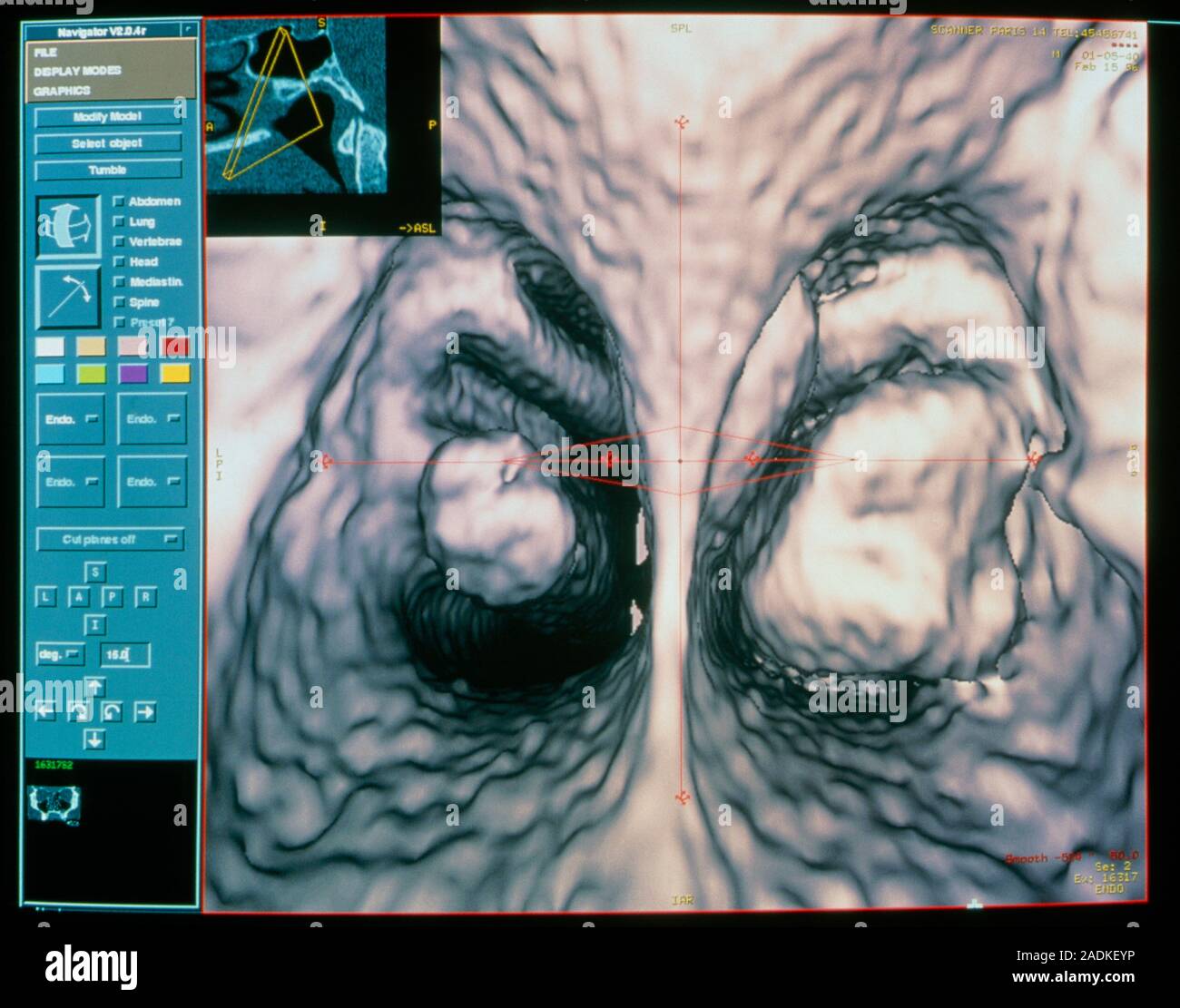 Nasal cavity. Three-dimensional computed tomo- graphy (CT) scan of the ...