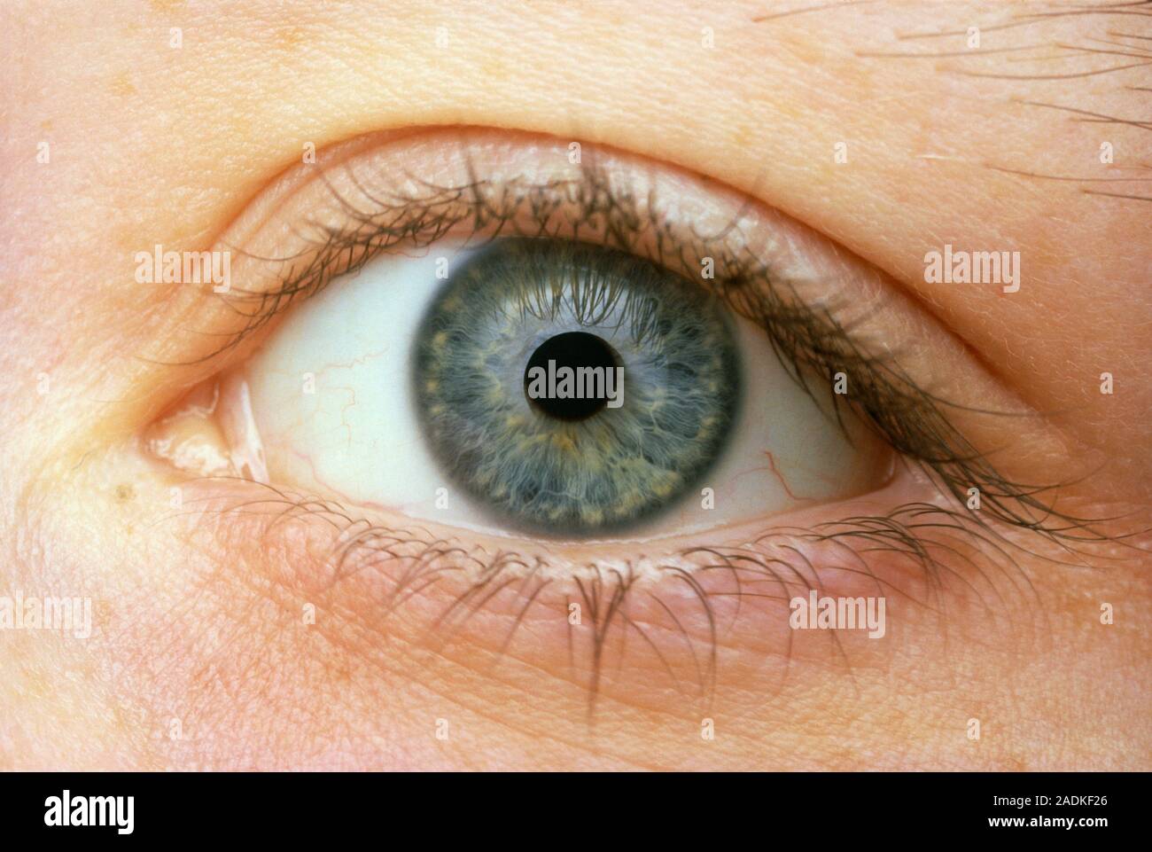 Photo of the right eye of a 23 year old woman showing the pupil ...