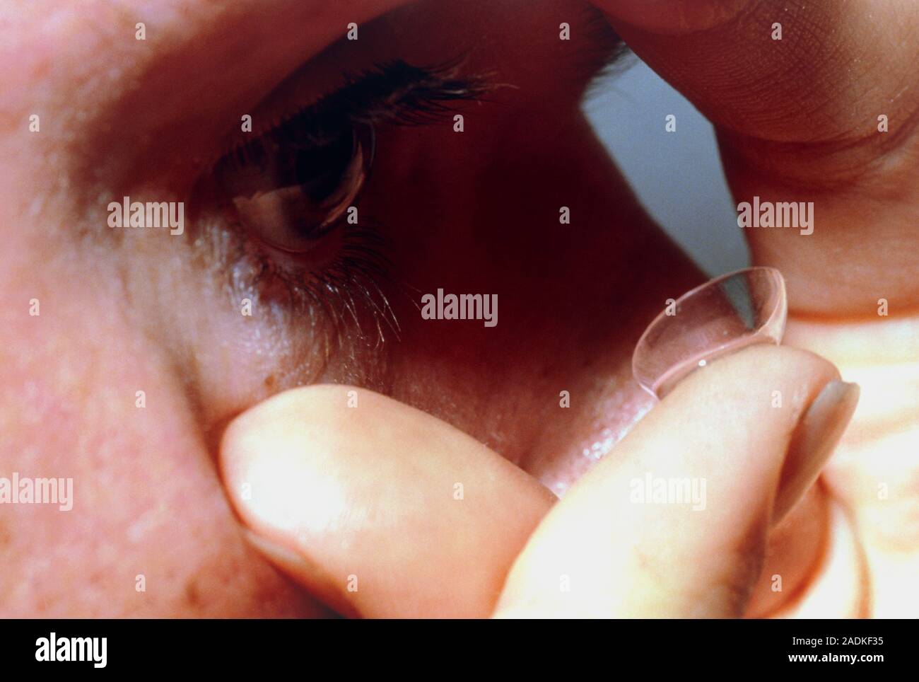 Soft-type contact lens designed for extended wear being placed over the ...