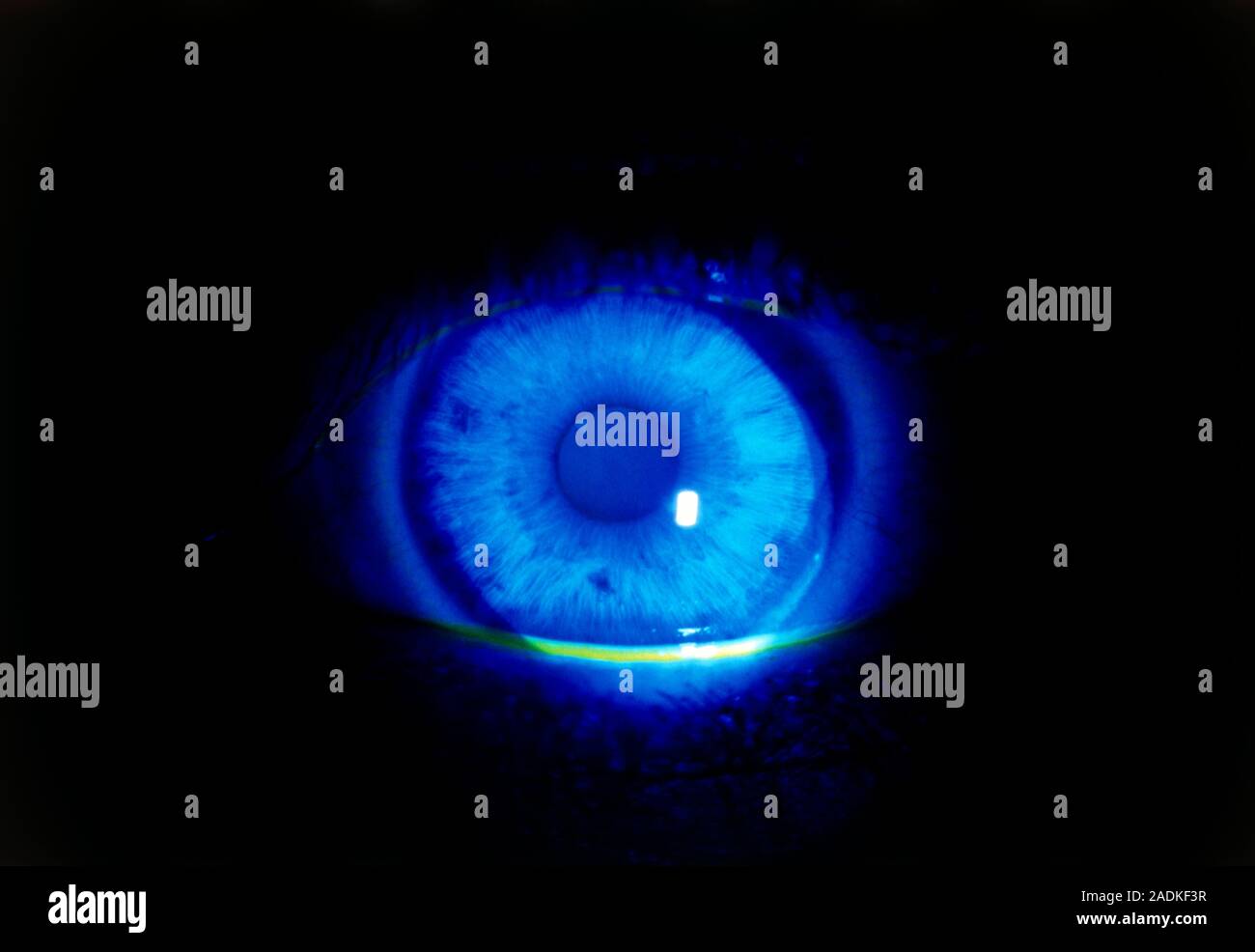 A healthy fluorescin-treated eye under ultraviolet light. Fluorescin is ...
