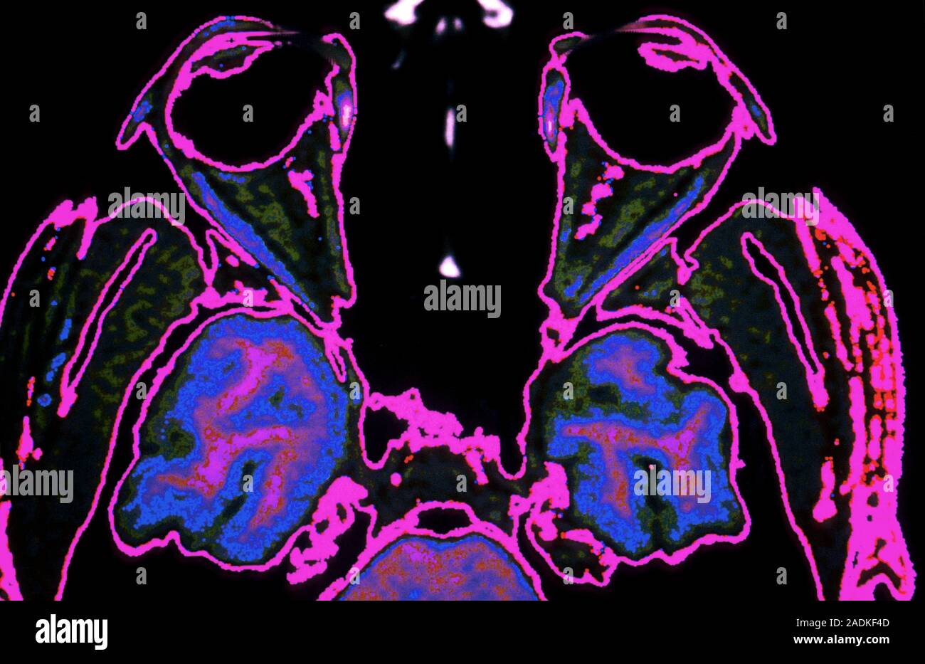 Eye anatomy. Coloured Magnetic Resonance Imaging (MRI) scan of a human ...
