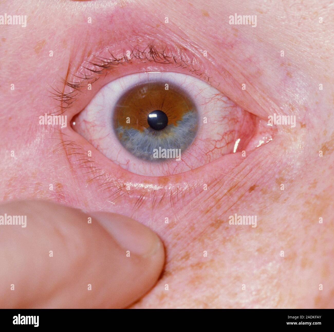 Two-coloured eye (monocular heterochromia). Eye being held open to show ...