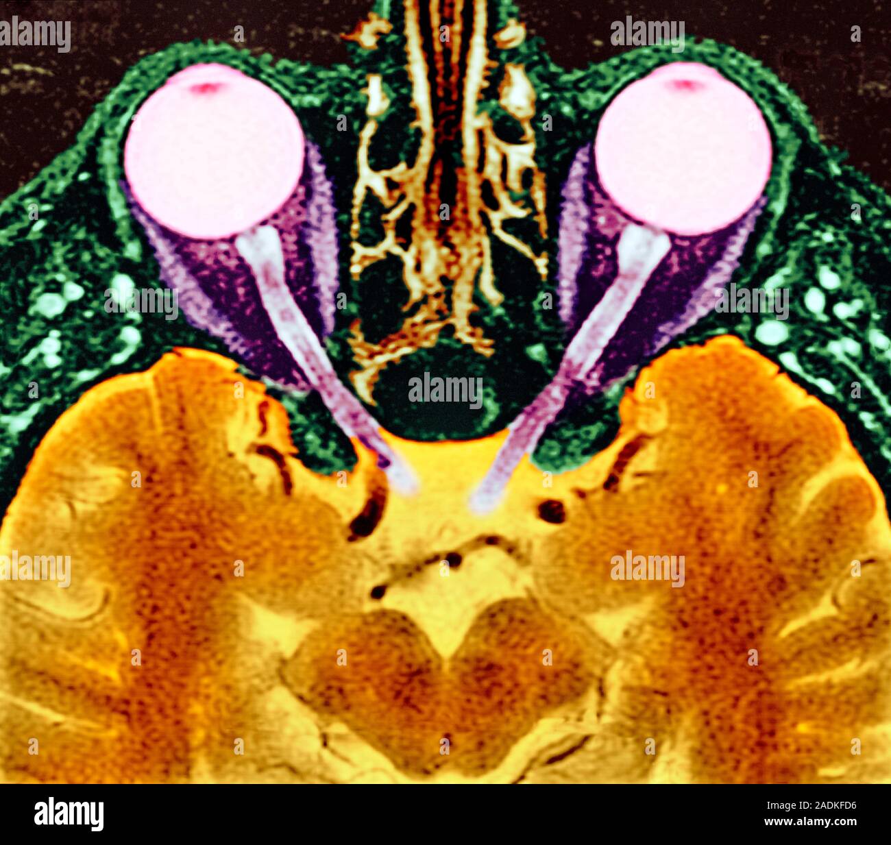 Vision and the brain. Coloured Magnetic Resonance Imaging (MRI) scan of ...
