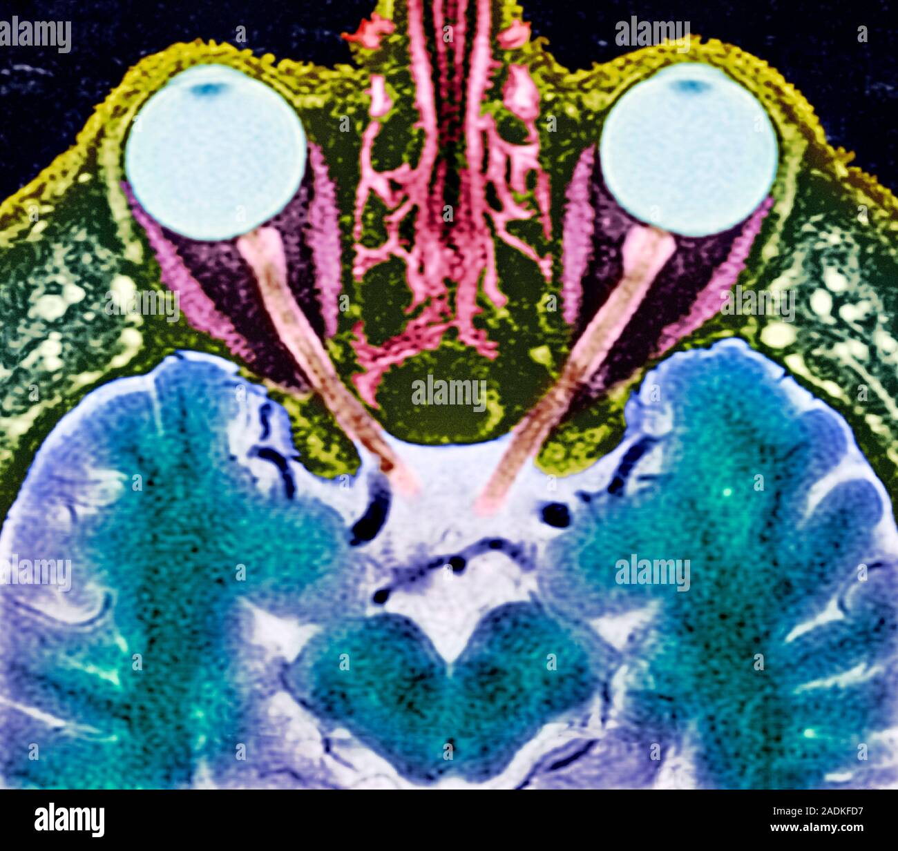 Vision and the brain. Coloured Magnetic Resonance Imaging (MRI) scan of ...
