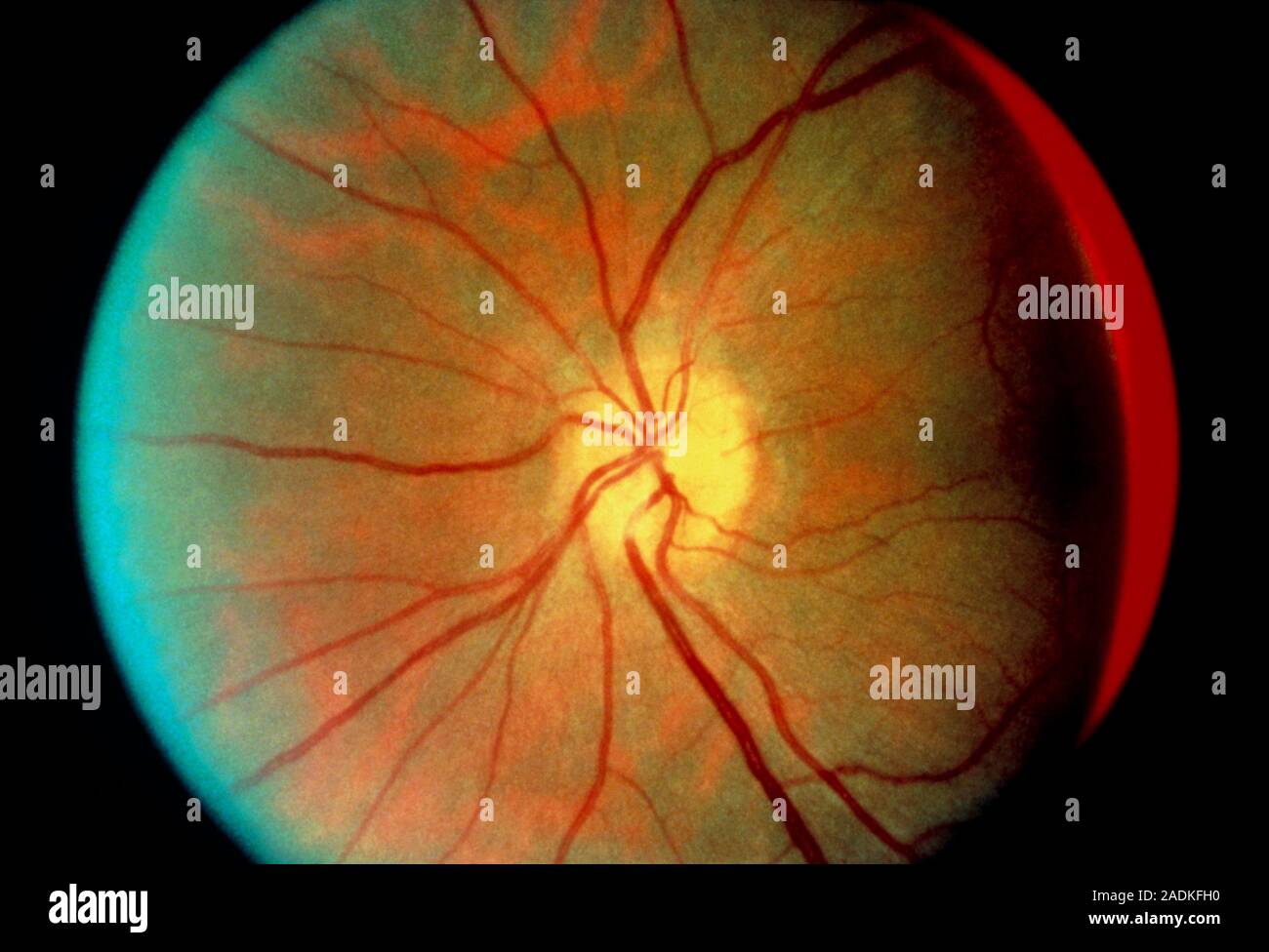 Fundus camera image of a normal, healthy retina of a human eye. In the ...