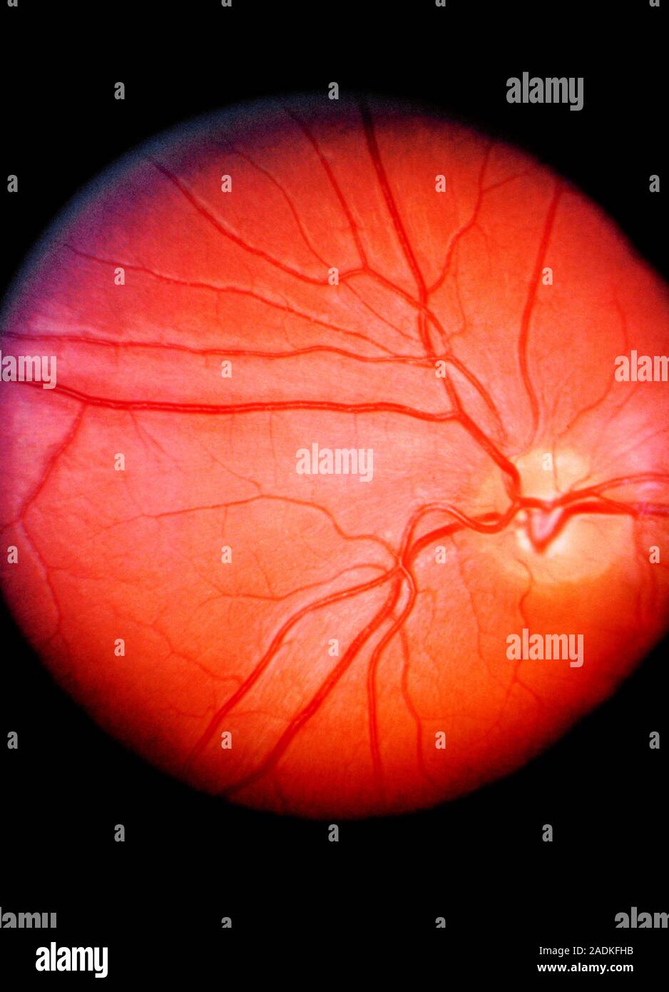 Normal Retina