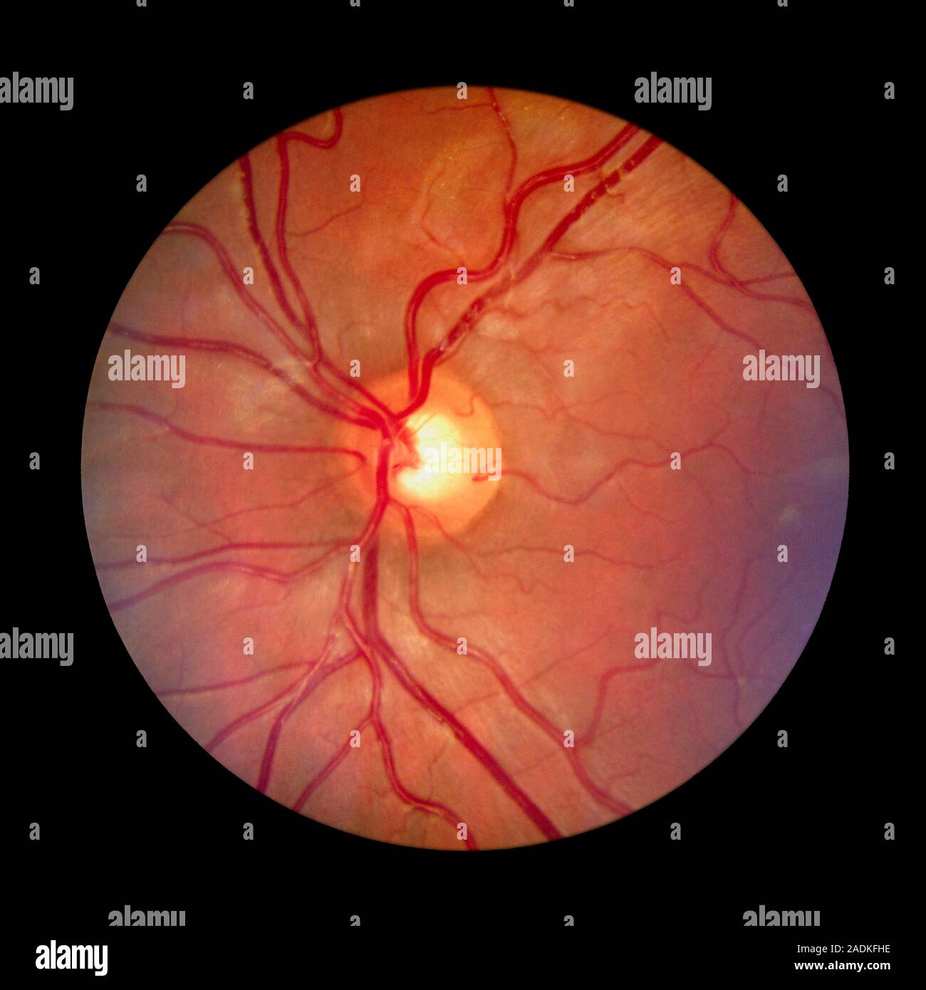 Fundus camera image of the retina of a normal eye, showing the ...