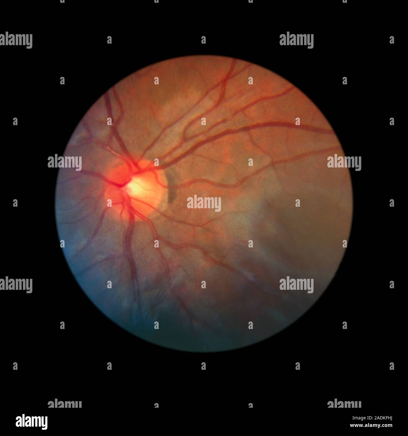 Normal Retinal Photo