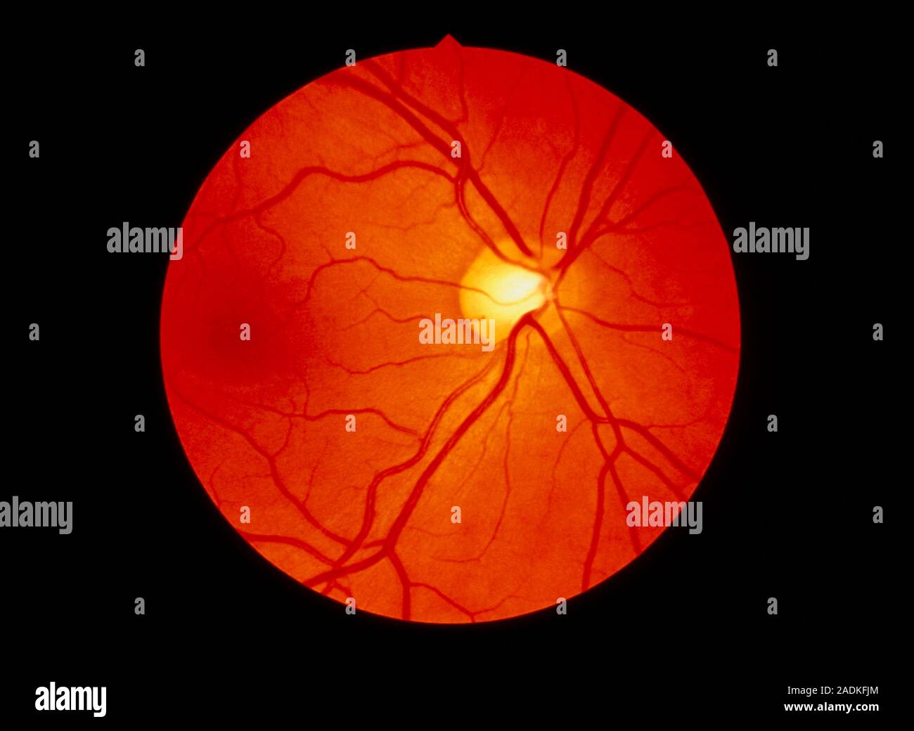 Normal retina. Ophthalmoscope view of the retina of a healthy human eye ...