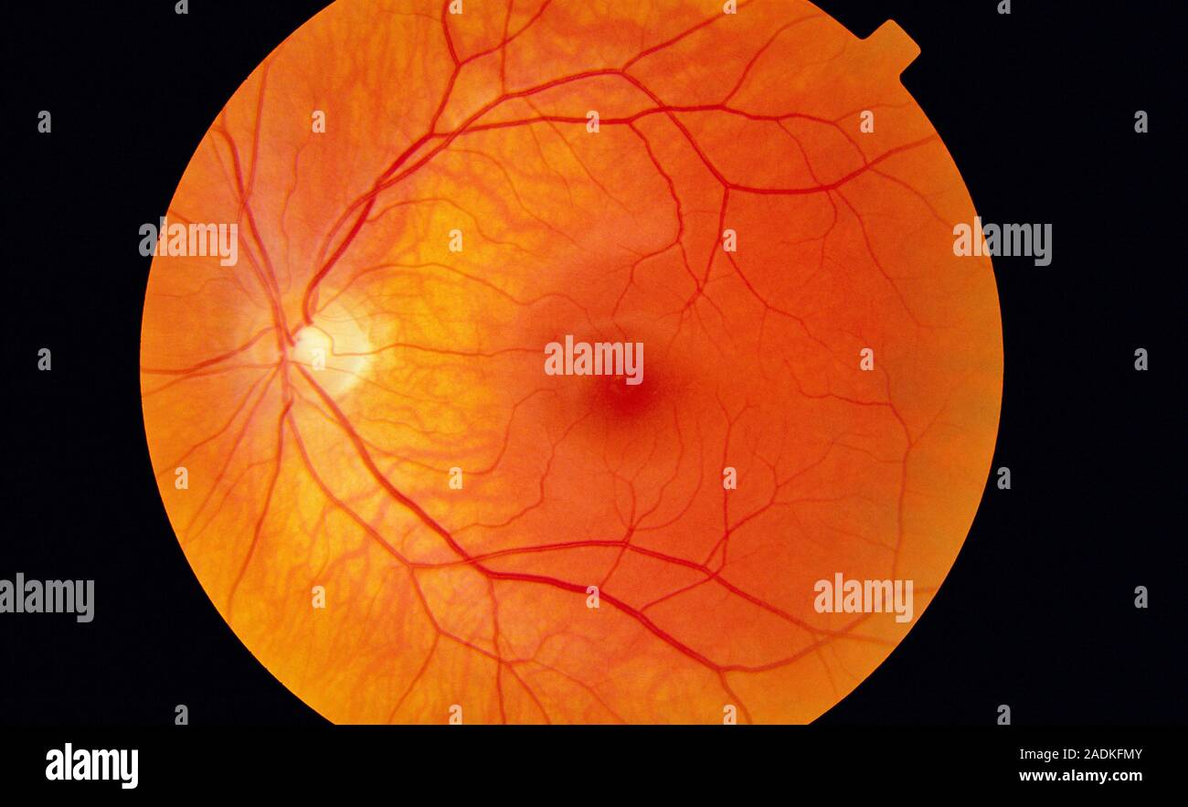 Normal retina, ophthalmoscope image. The retina is the light-sensitive ...
