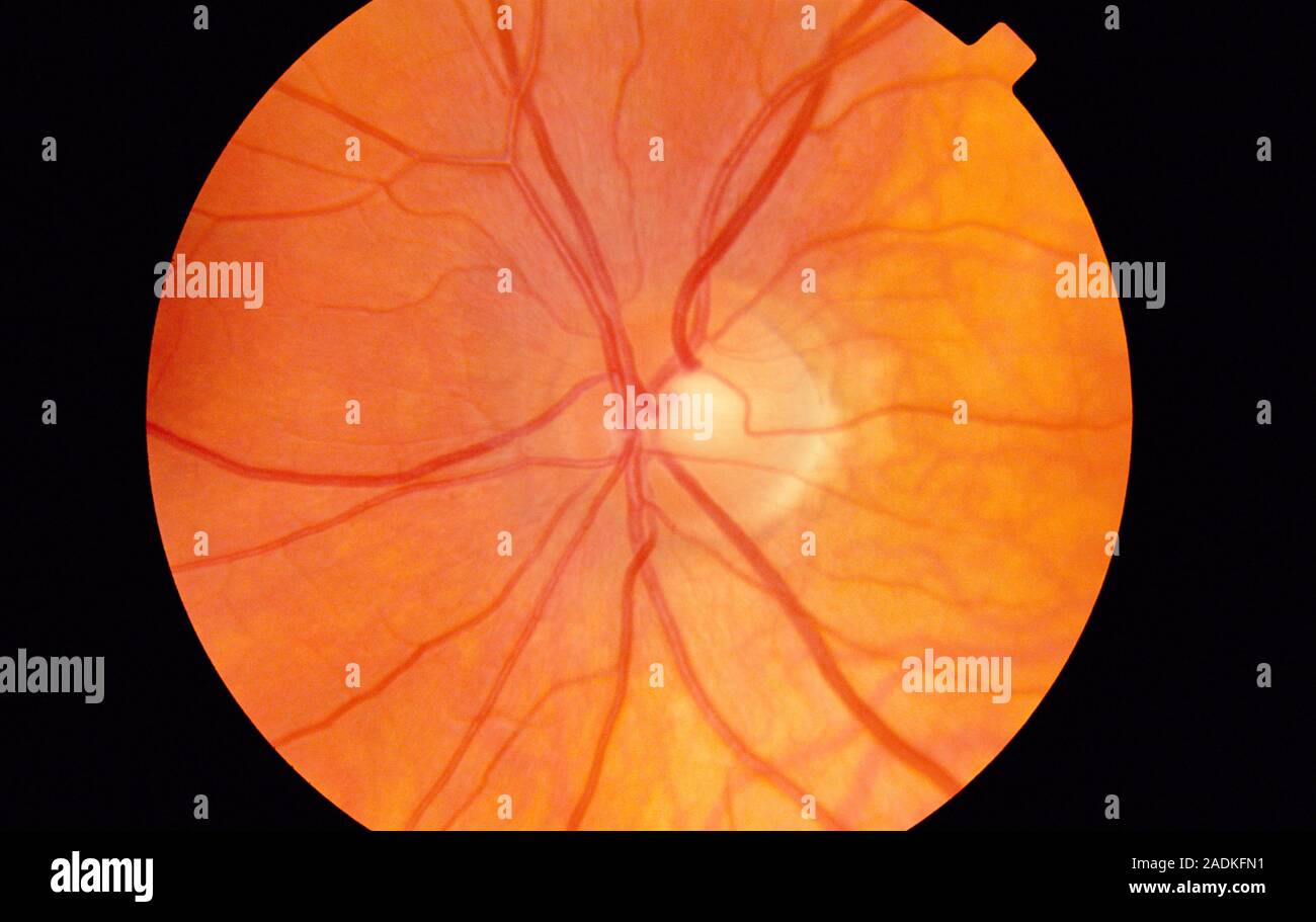Normal retina, ophthalmoscope image. The retina is the light-sensitive ...