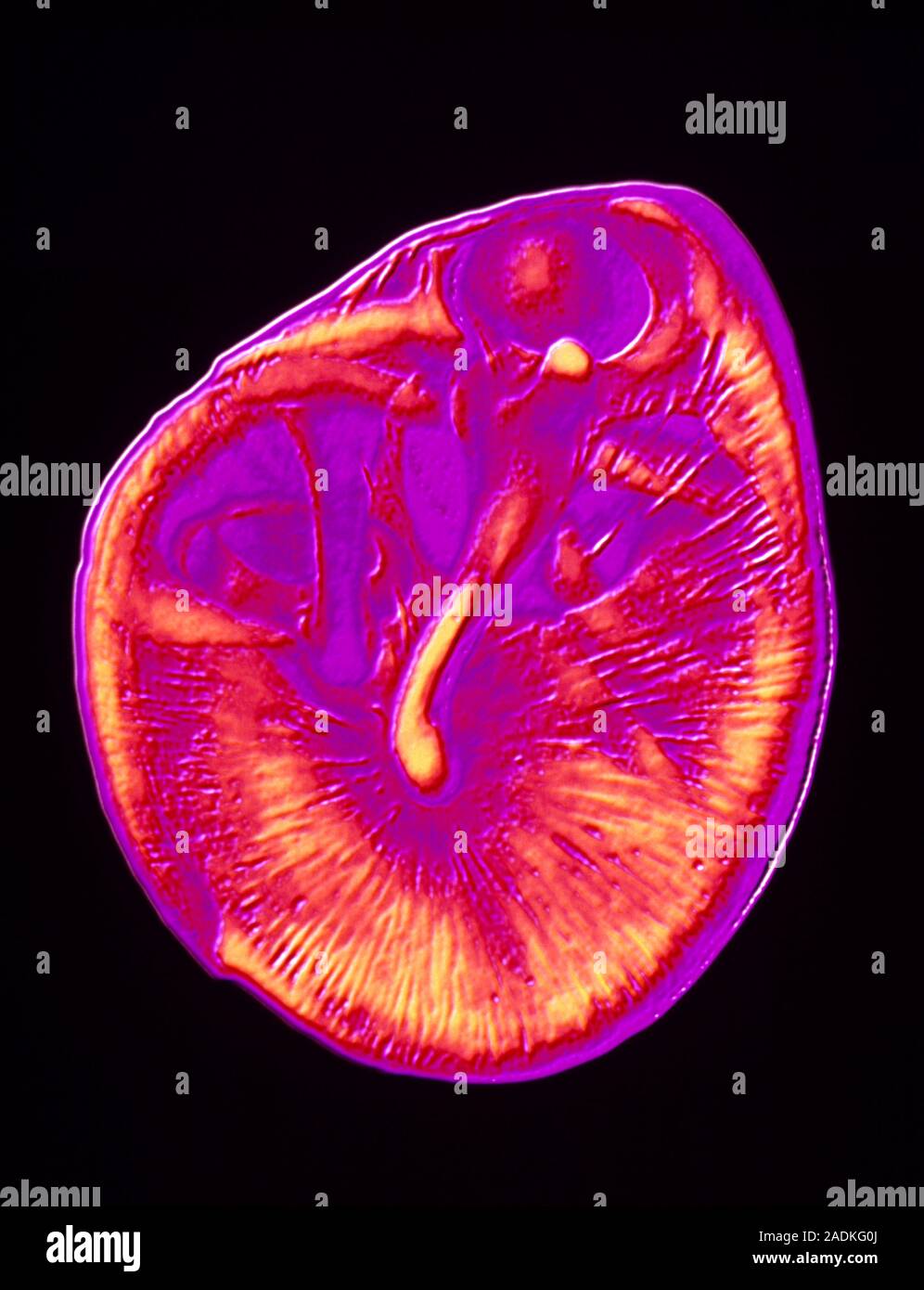 Eardrum. Computer graphic showing the human ear- drum (tympanic ...