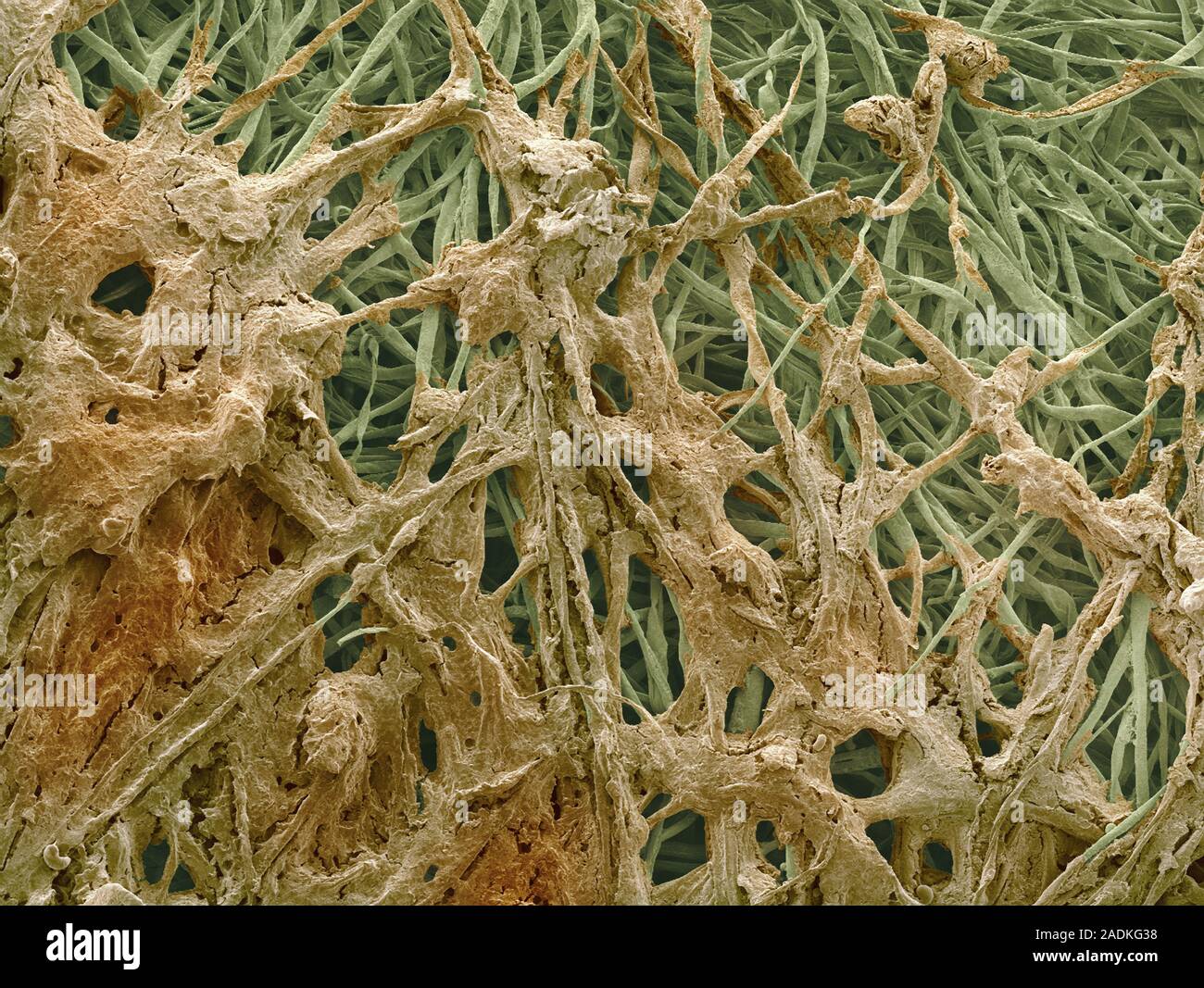 Ear wax. Coloured scanning electron micrograph (SEM) of ear wax (brown ...