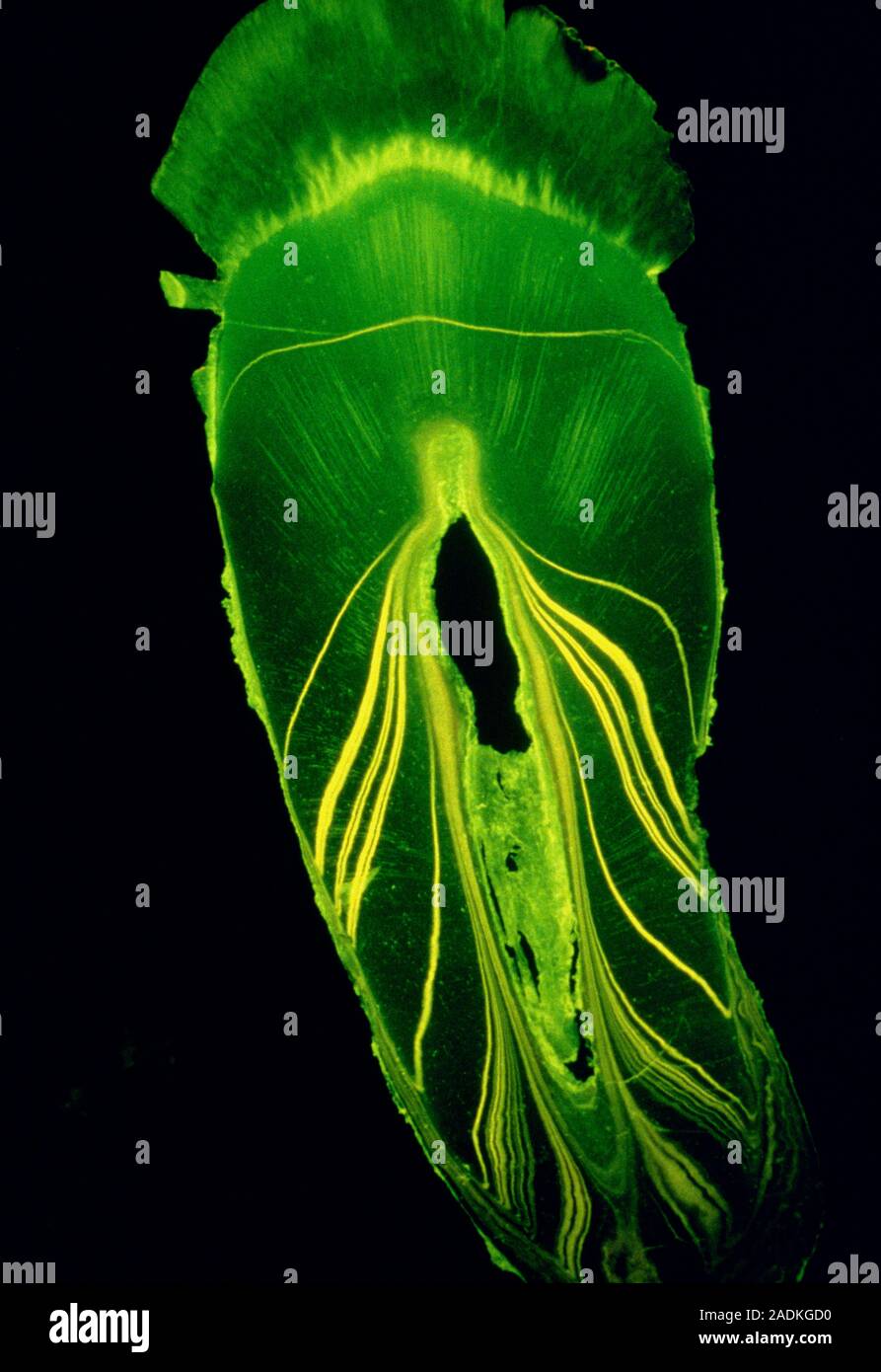 Antibiotic-stained tooth. Light micrograph of a longitudinal section ...