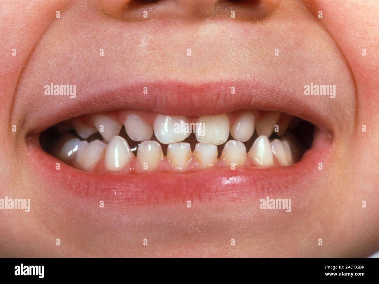 Milk teeth. Close-up of the mouth of a four year old boy showing his ...