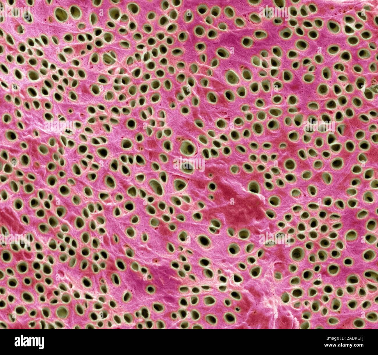 Tooth dentine. Coloured scanning electron micrograph (SEM) of dentine ...