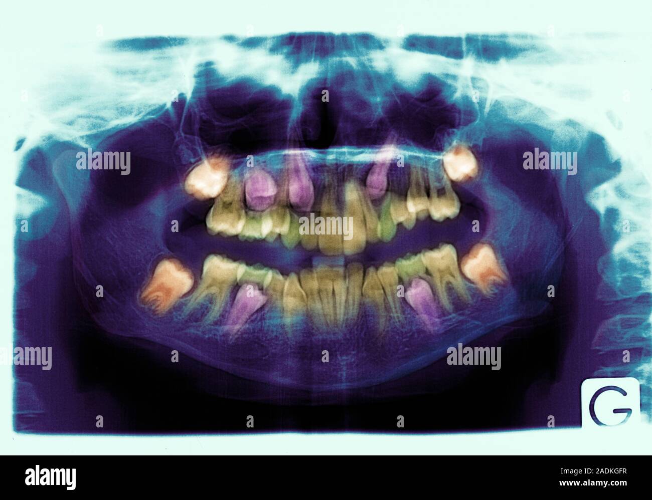 Emergence of adult teeth. Panoramic dental X-ray of the mouth of a 12 ...