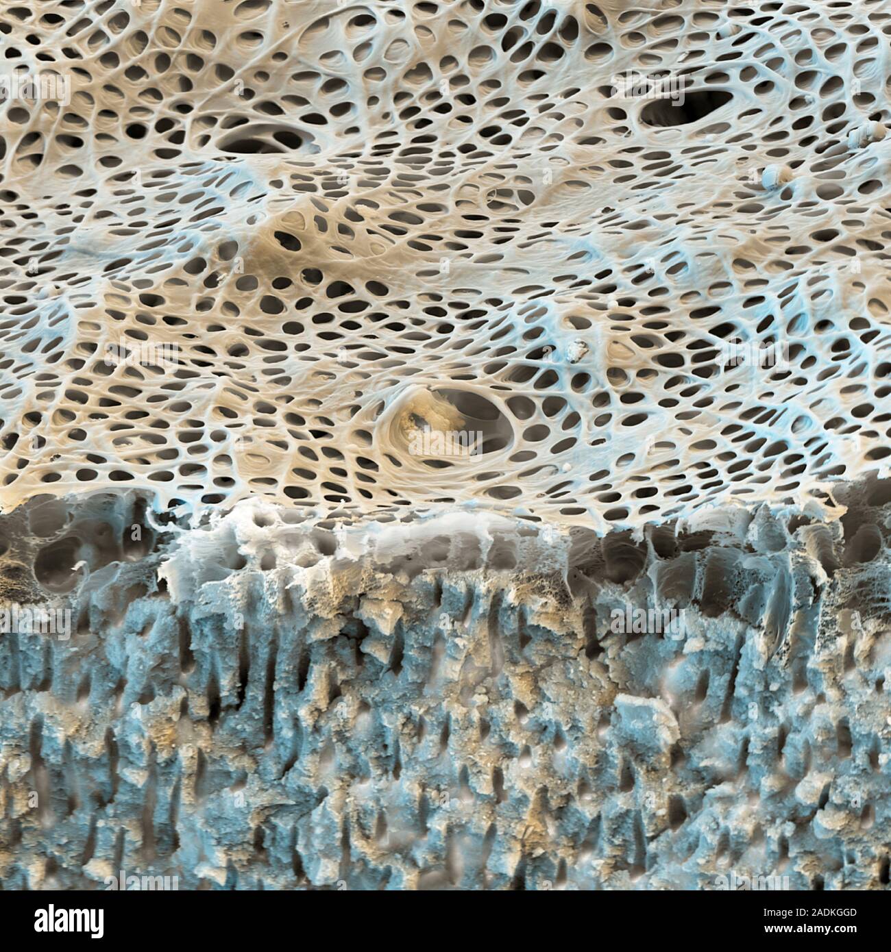 Tooth dentine. Coloured scanning electron micrograph (SEM) of dentine ...