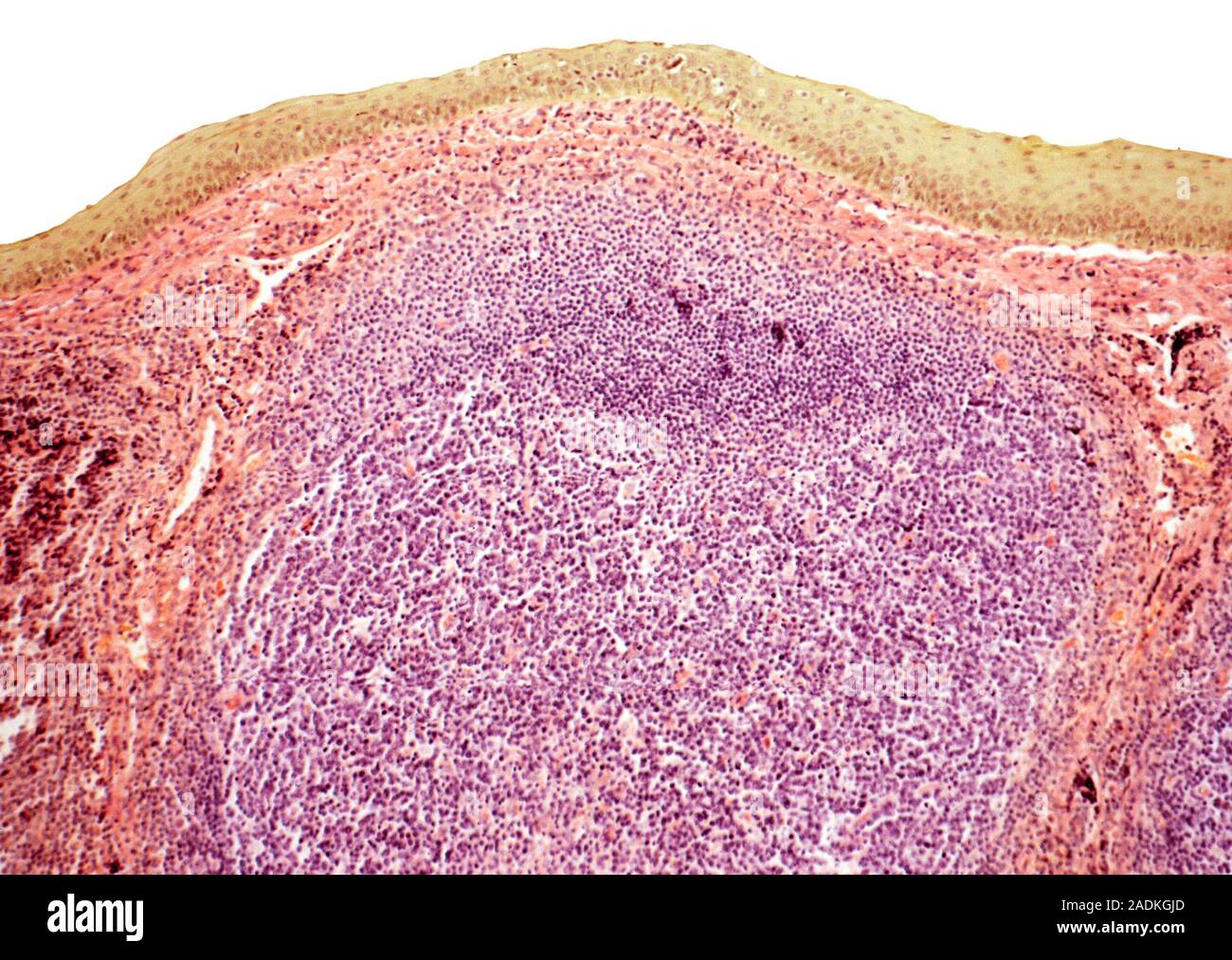 Tonsil. Light micrograph of a section through the surface of a tonsil ...