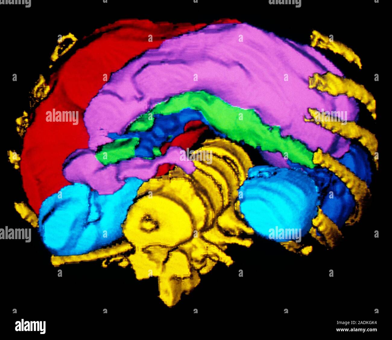 False-colour, three-dimensional computed tomography (CT) scan of a ...