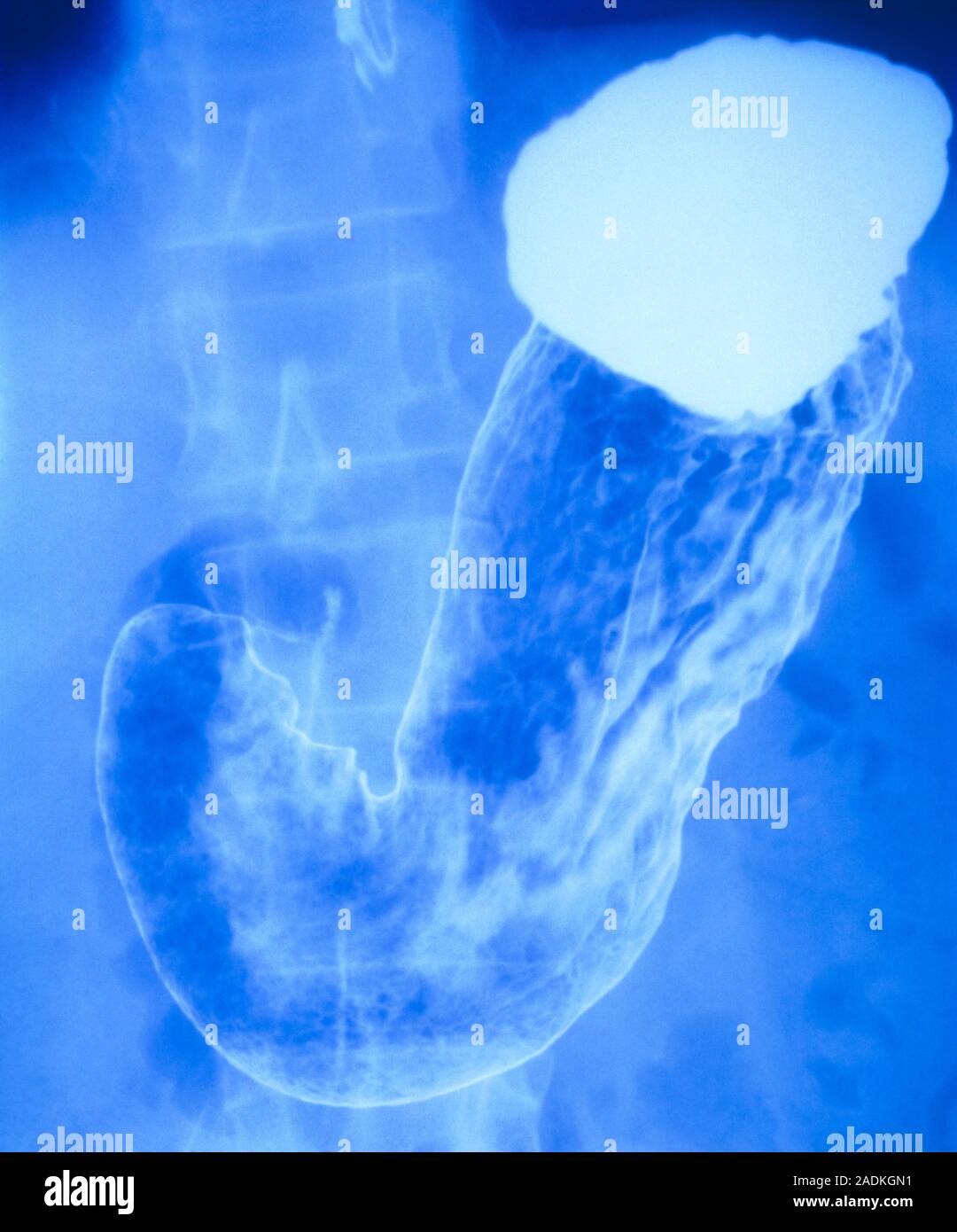 Double-contrast barium meal X-ray image of a normal human stomach ...